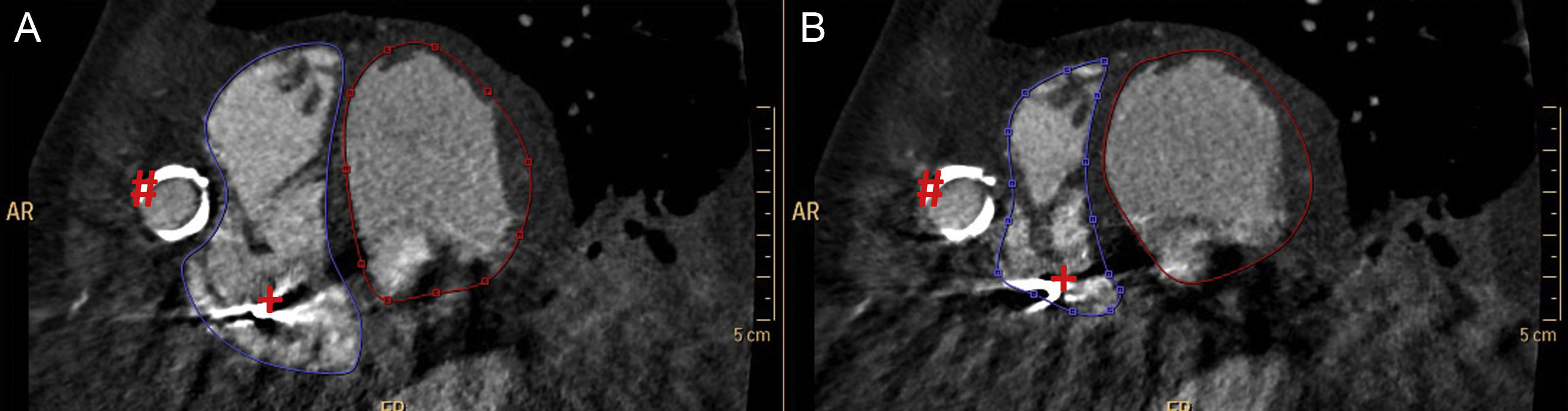 Comprehensive Assessment of the Heartware HVAD Left Ventricular Assist ...