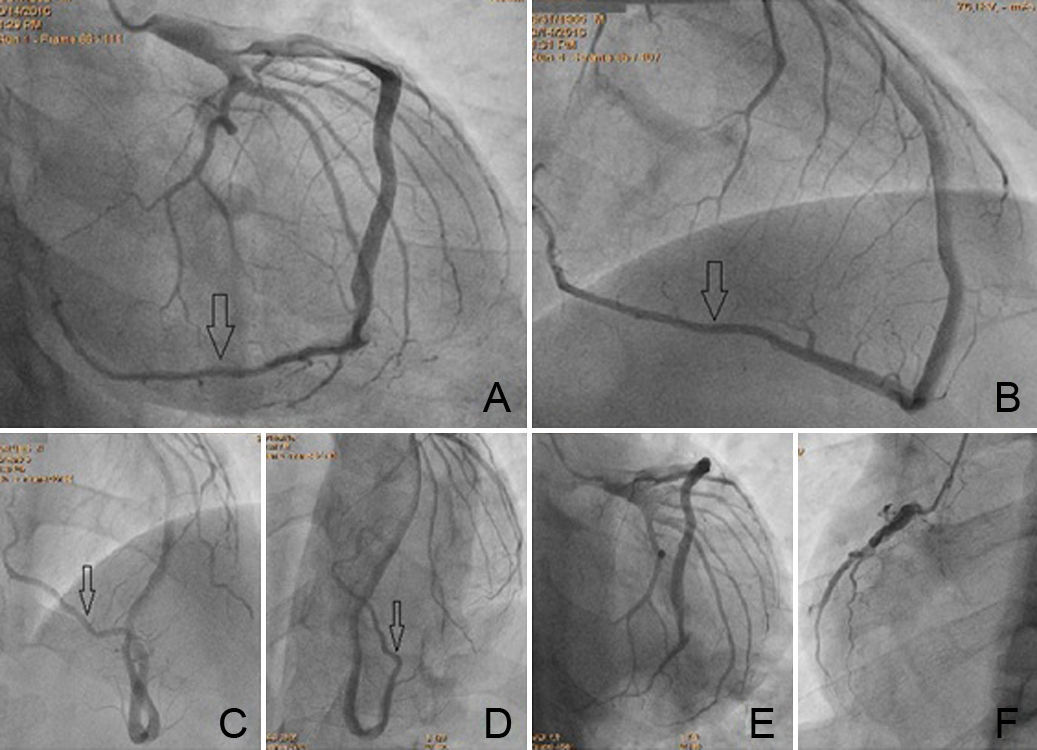 Super Dominant Left Anterior Descending Coronary Artery | Revista ...