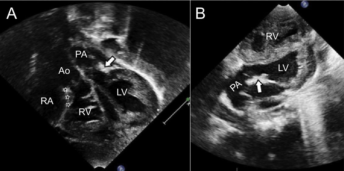 TGA+VSD and Subpulmonary Conus: From Fetus to a 3-dimensional Model