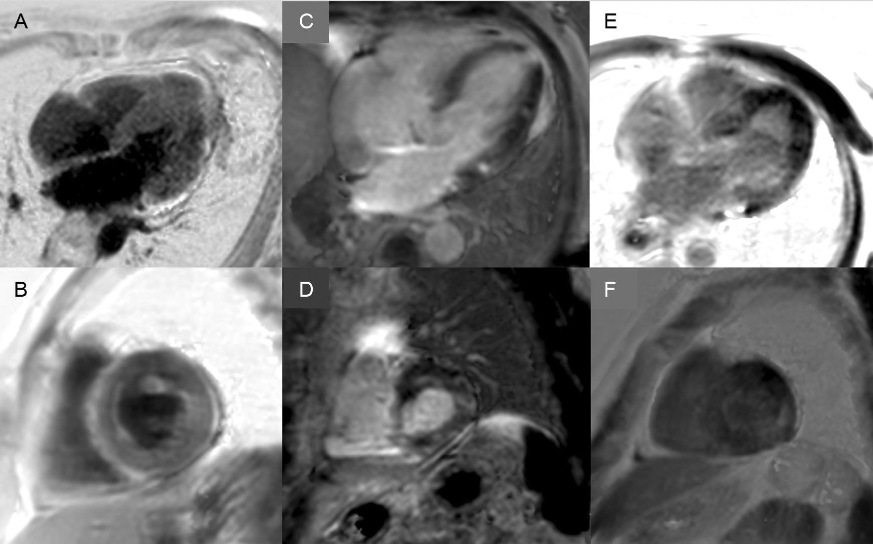 Diagnosis and Treatment of Transthyretin Cardiac Amyloidosis. Progress ...