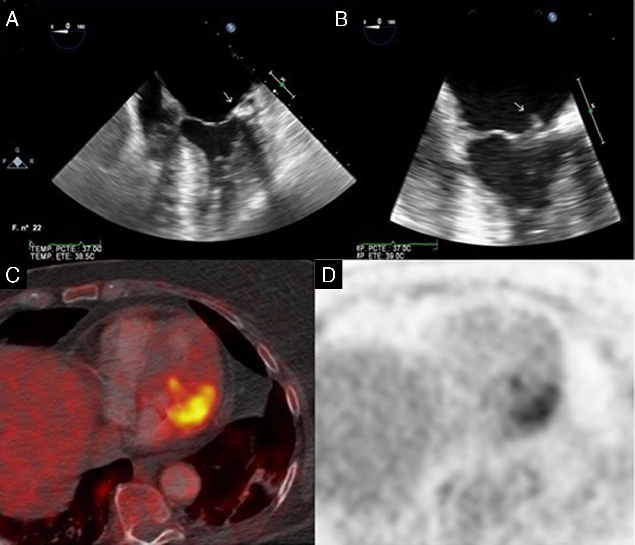 Austrian Syndrome Complicated With a Periannular Mitral Abscess ...