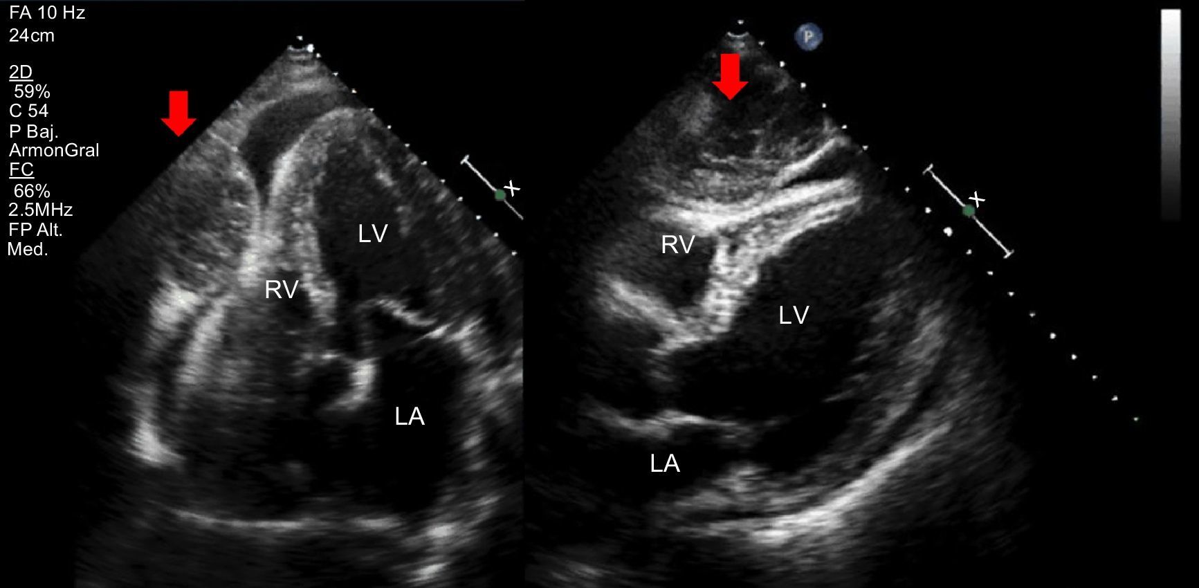 Chondrosarcoma: Extrinsic Compression of the Right Ventricle and ...