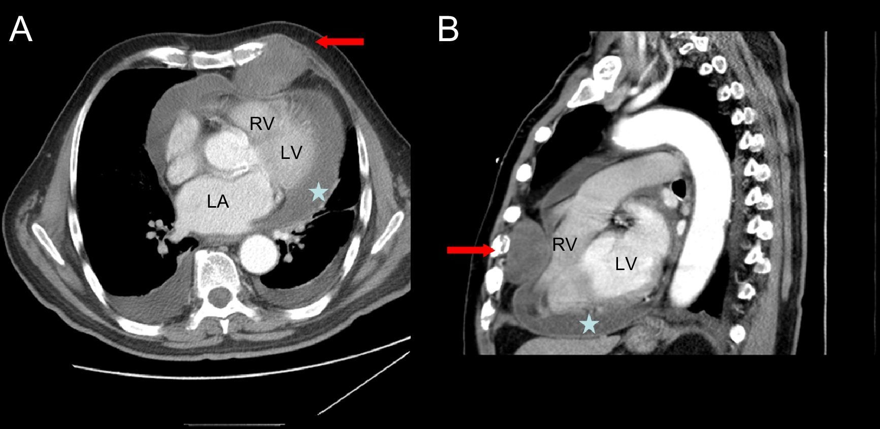 Chondrosarcoma: Extrinsic Compression of the Right Ventricle and ...