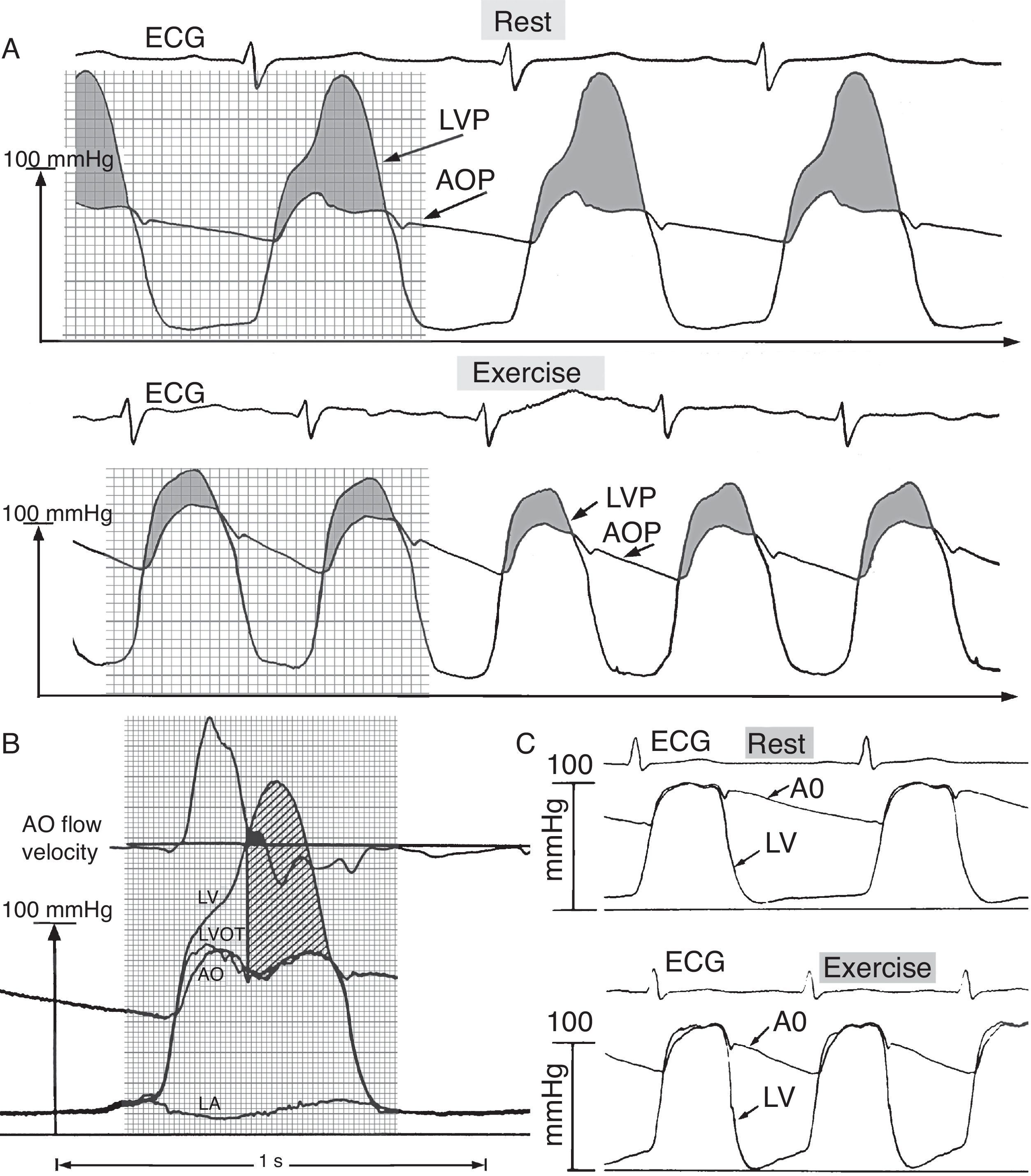 Challenges and Controversies in Hypertrophic Cardiomyopathy: Clinical ...