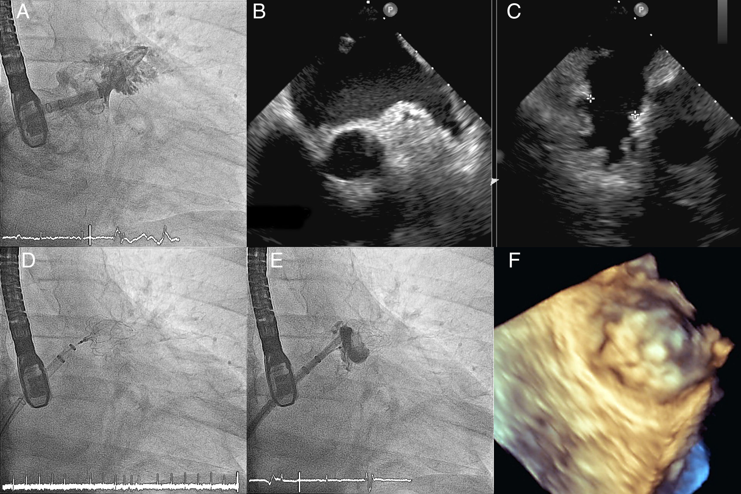 Selection of the Best of 2017 in Left Atrial Appendage Occlusion ...