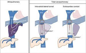 Fontan-associated Liver Disease | Revista Española de Cardiología