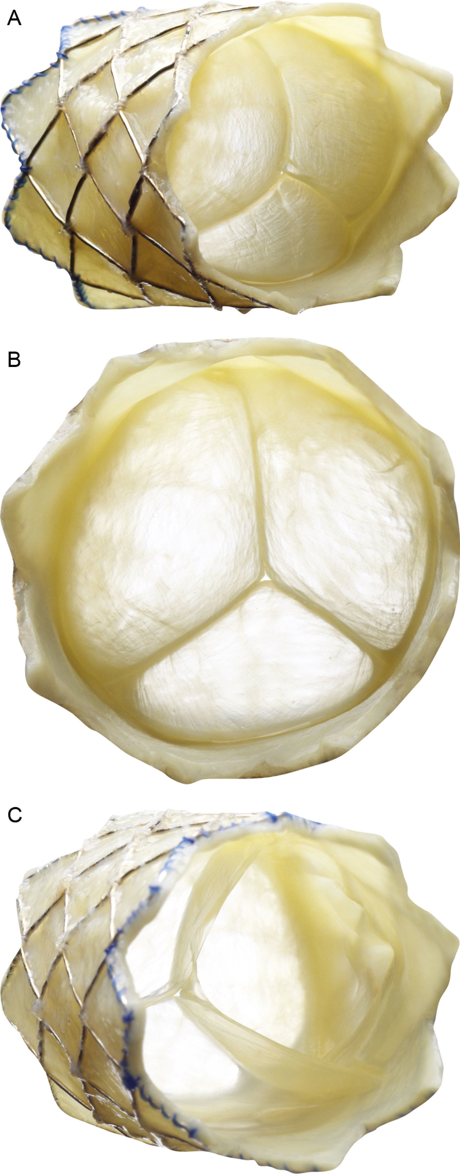Pediatrics Spanish Registry of Percutaneous Melody Pulmonary Valve ...