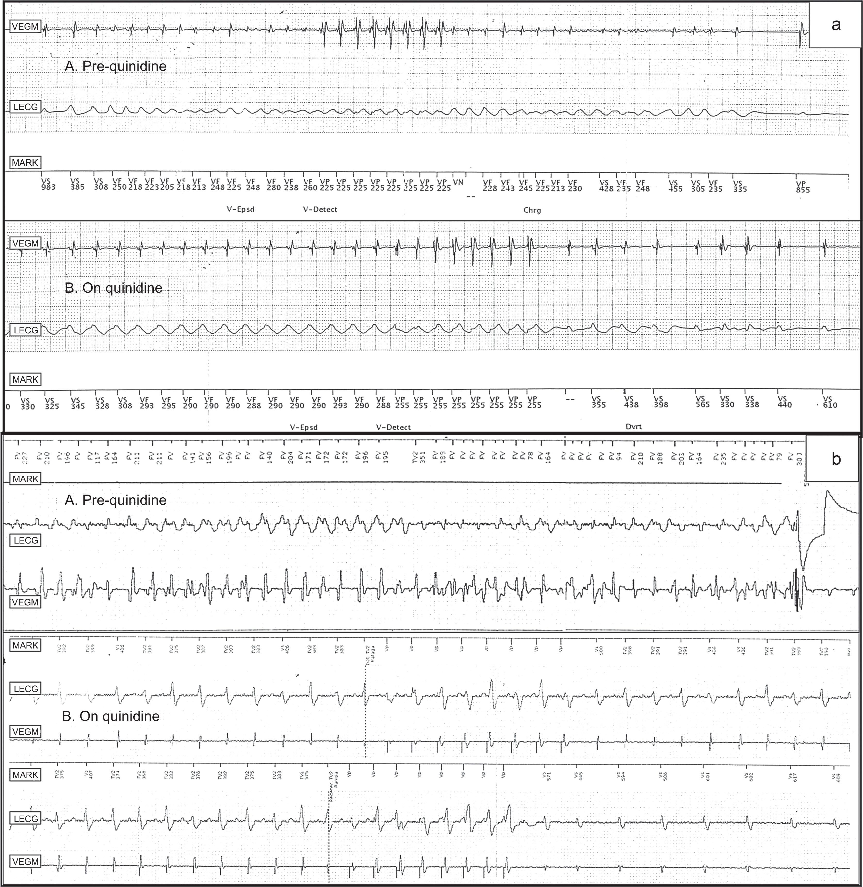 Antitachycardia Pacing Effectiveness for Monomorphic Ventricular ...