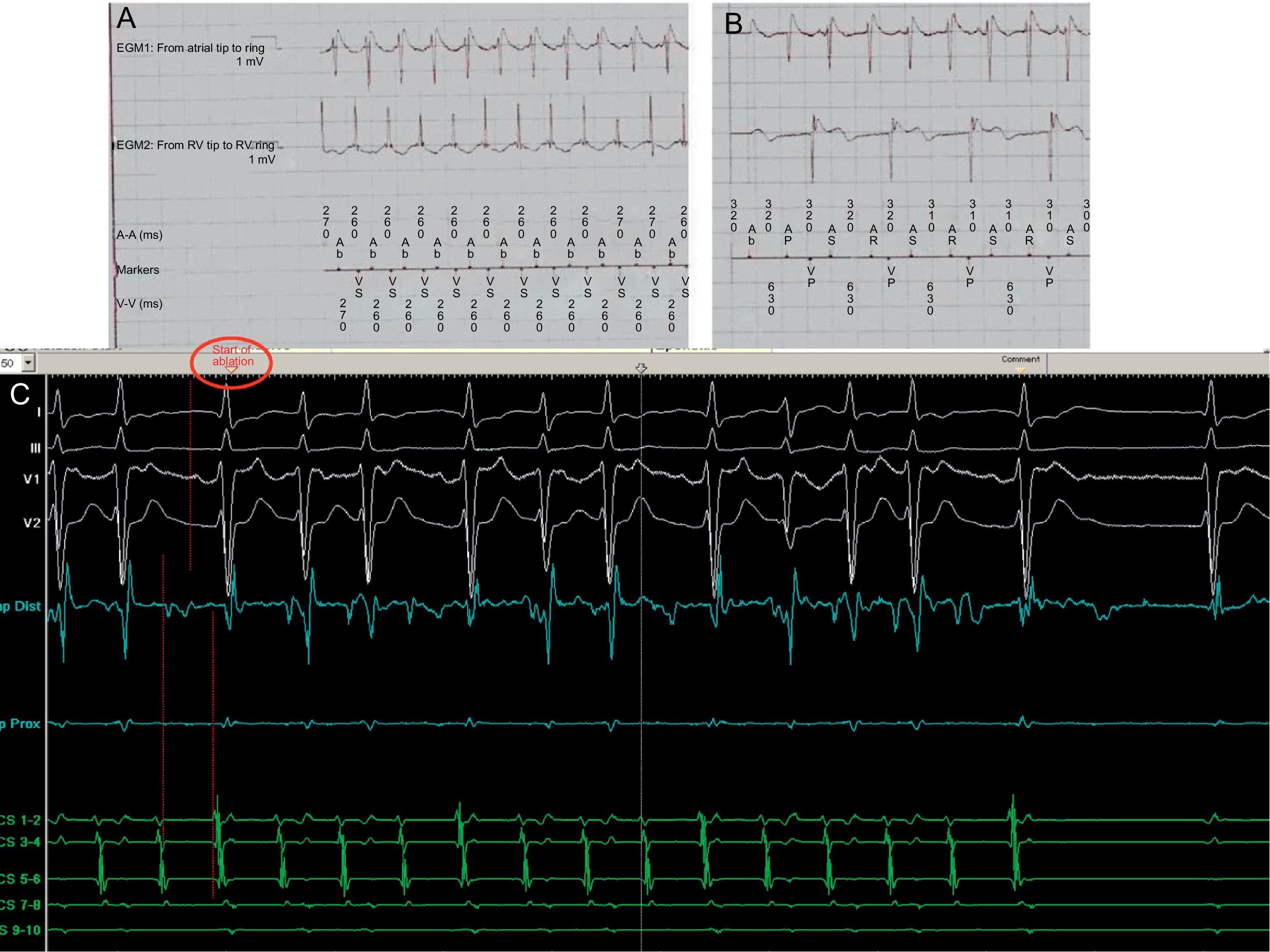 Rheumatoid Arthritis With Severe Atrial Fibrosis and Multiple Atrial ...