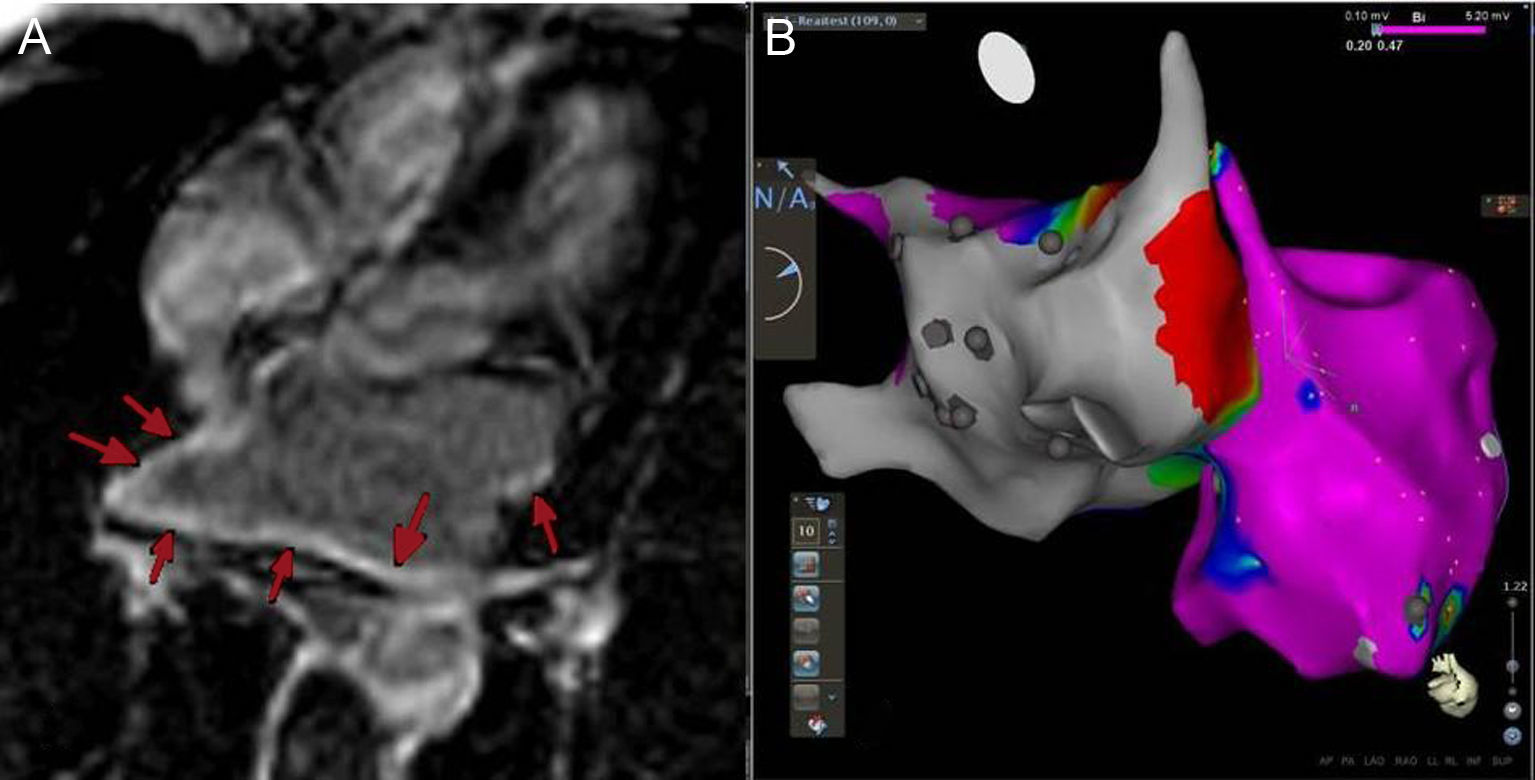 Rheumatoid Arthritis With Severe Atrial Fibrosis and Multiple Atrial ...