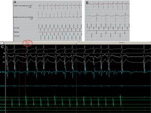 Rheumatoid Arthritis With Severe Atrial Fibrosis and Multiple Atrial ...