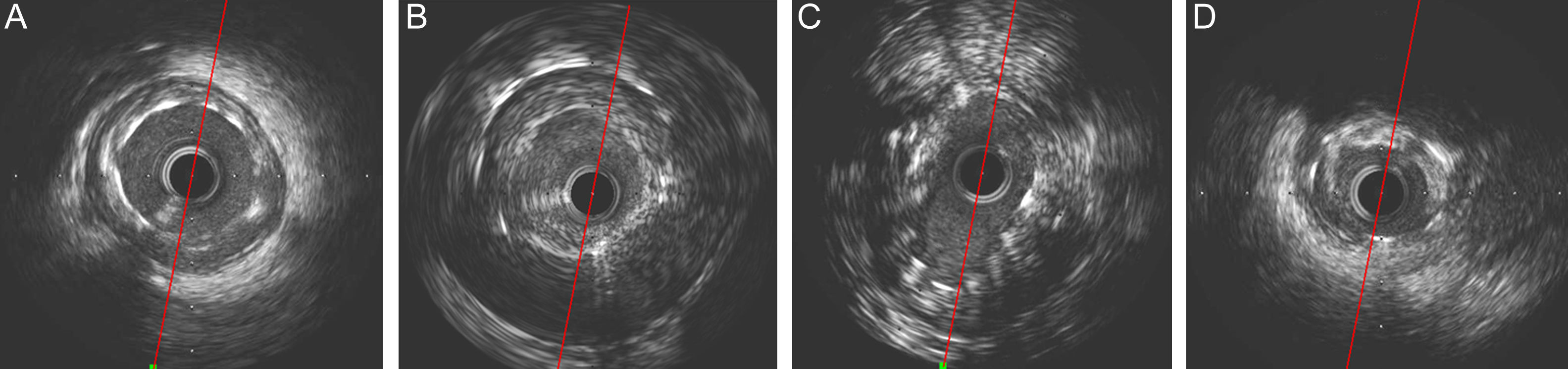 IVUS Findings in Late and Very Late Stent Thrombosis. A Comparison ...