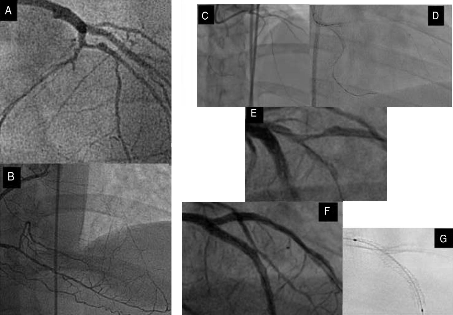 One Versus 2-stent Strategy for the Treatment of Bifurcation Lesions in ...