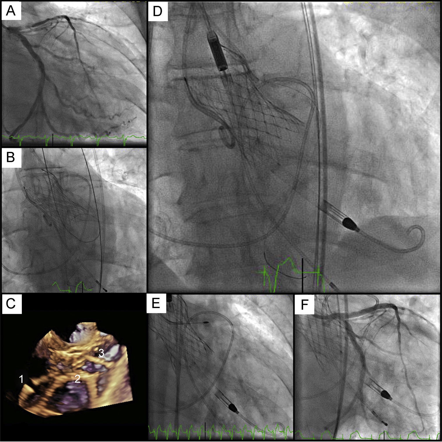 Transcatheter Aortic Valve, Impella and Complex Coronary Intervention ...