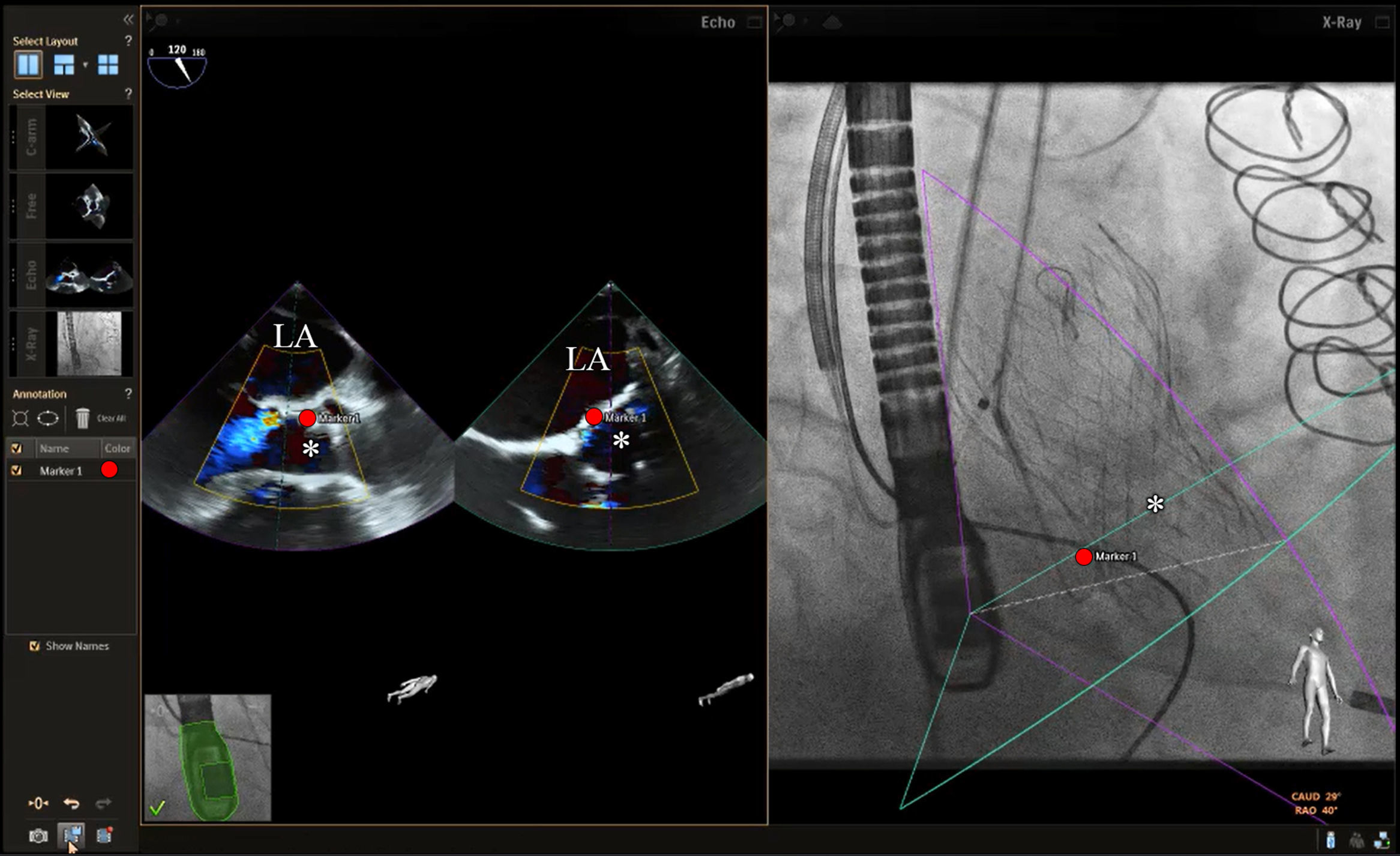 Fusion Imaging for Procedural Guidance | Revista Española de Cardiología