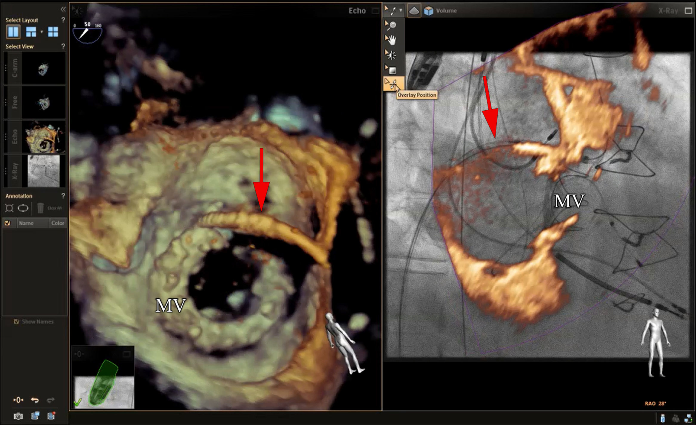 Fusion Imaging for Procedural Guidance | Revista Española de Cardiología