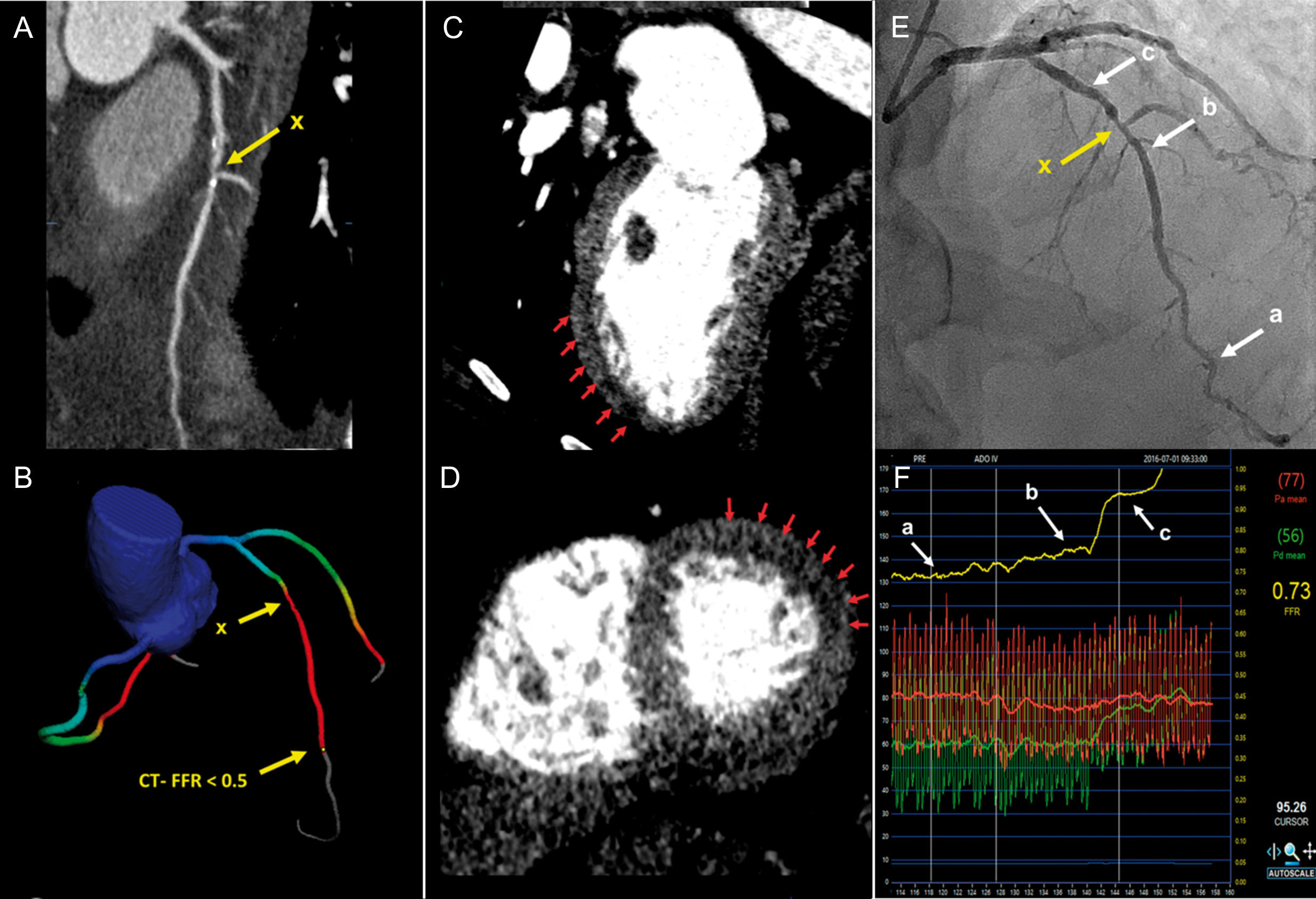 Hybrid Imaging in Ischemic Heart Disease | Revista Española de Cardiología