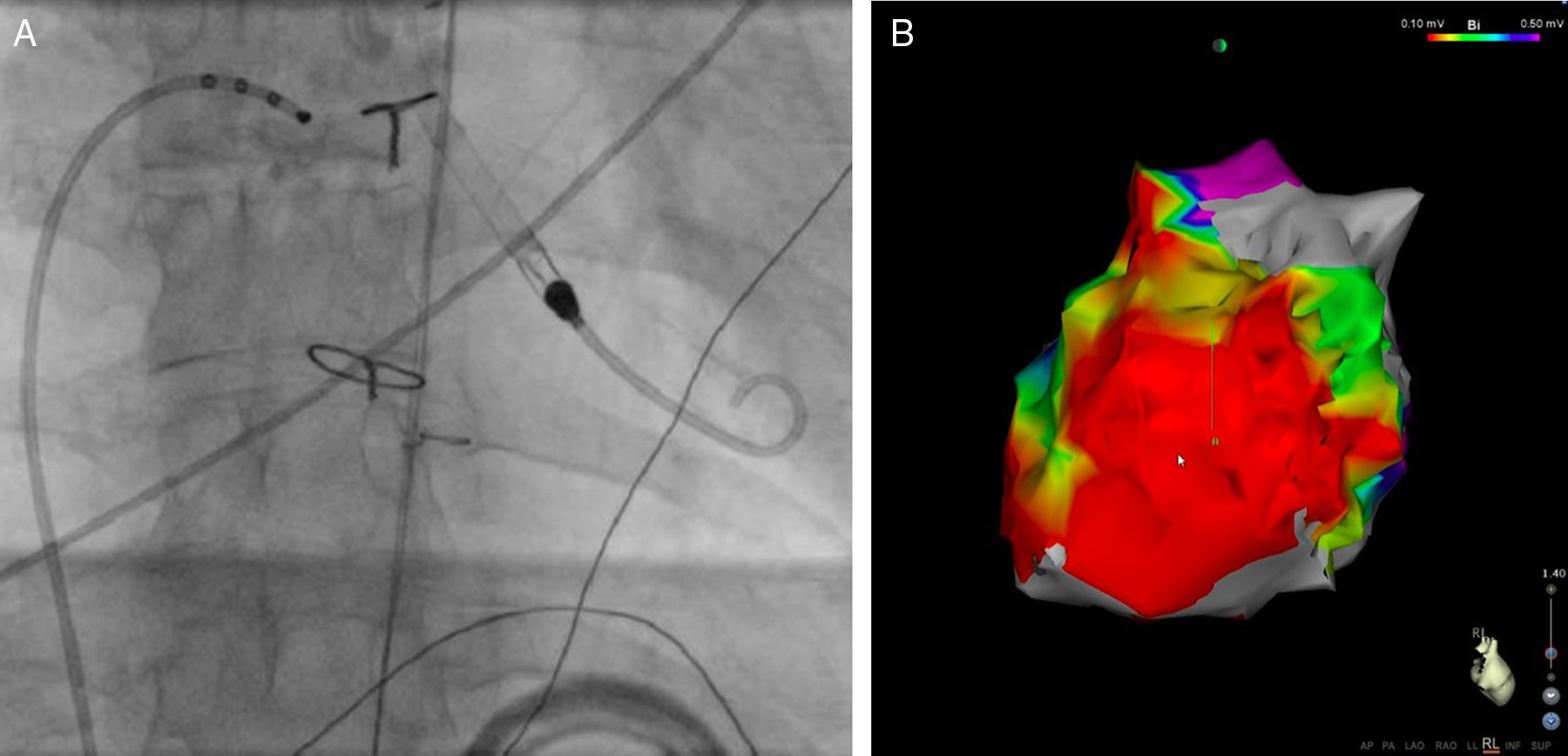 Percutaneous Ventricular Assist Device for Circulatory Support During ...
