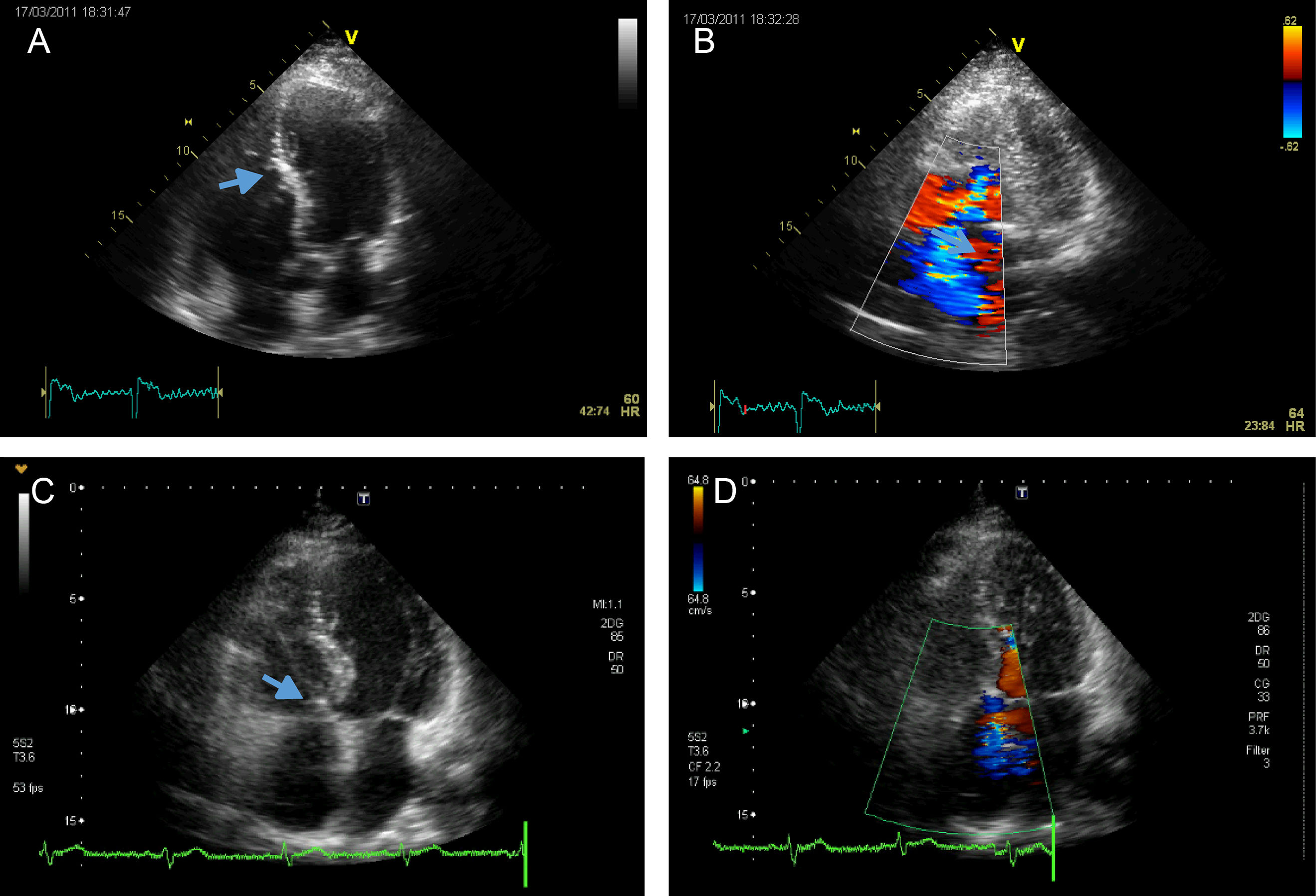 The Cone Technique for Ebstein Repair. First Cases | Revista Española ...