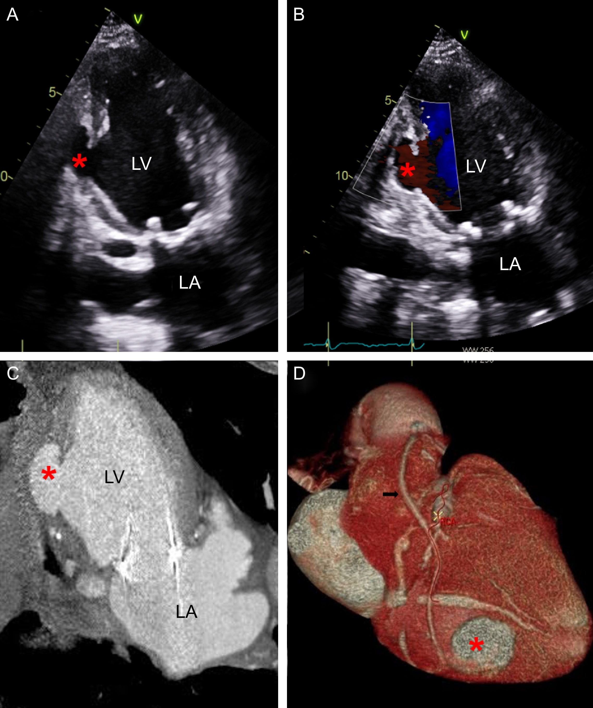 Survivor of a Double Mechanical Complication After Myocardial ...