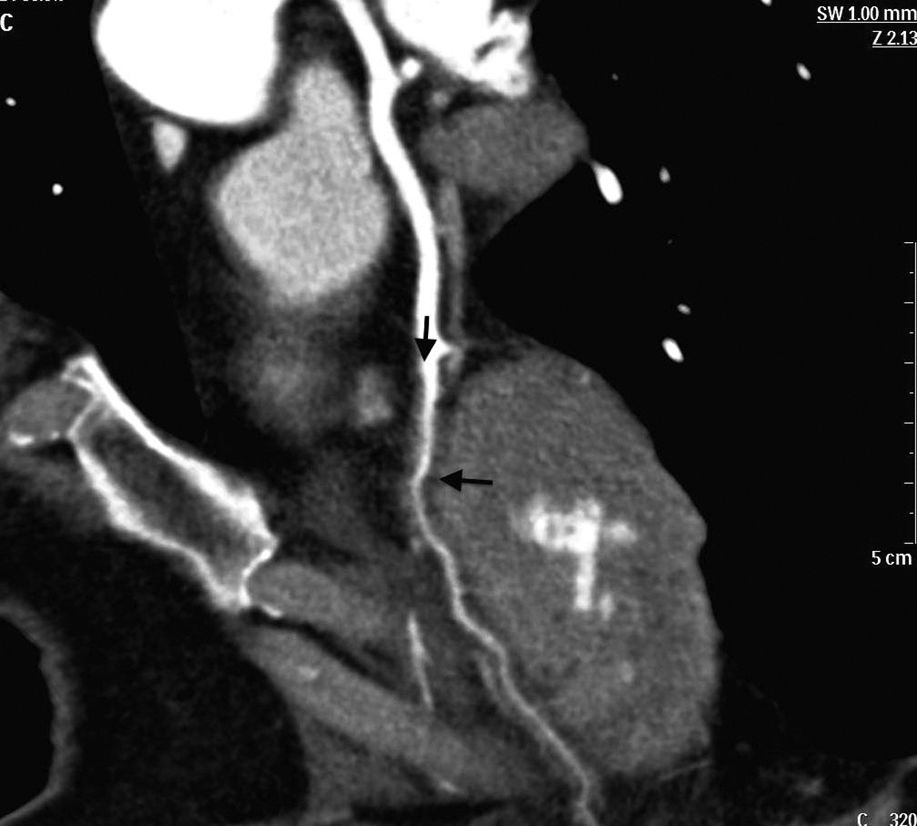 Coronary Intramural Hematoma Visualized on Multislice CT Angiography ...