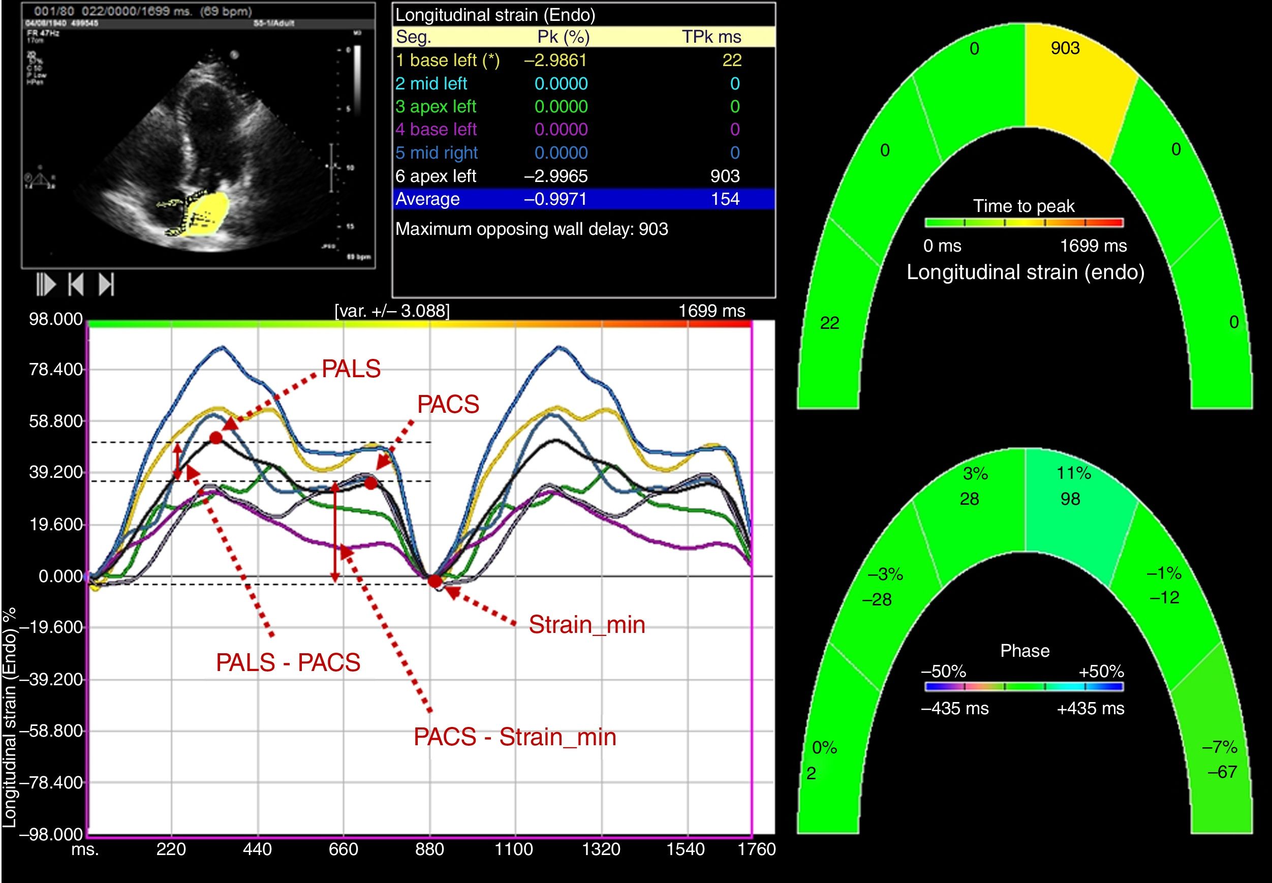 Impaired Left Atrial Strain as a Predictor of New-onset Atrial ...