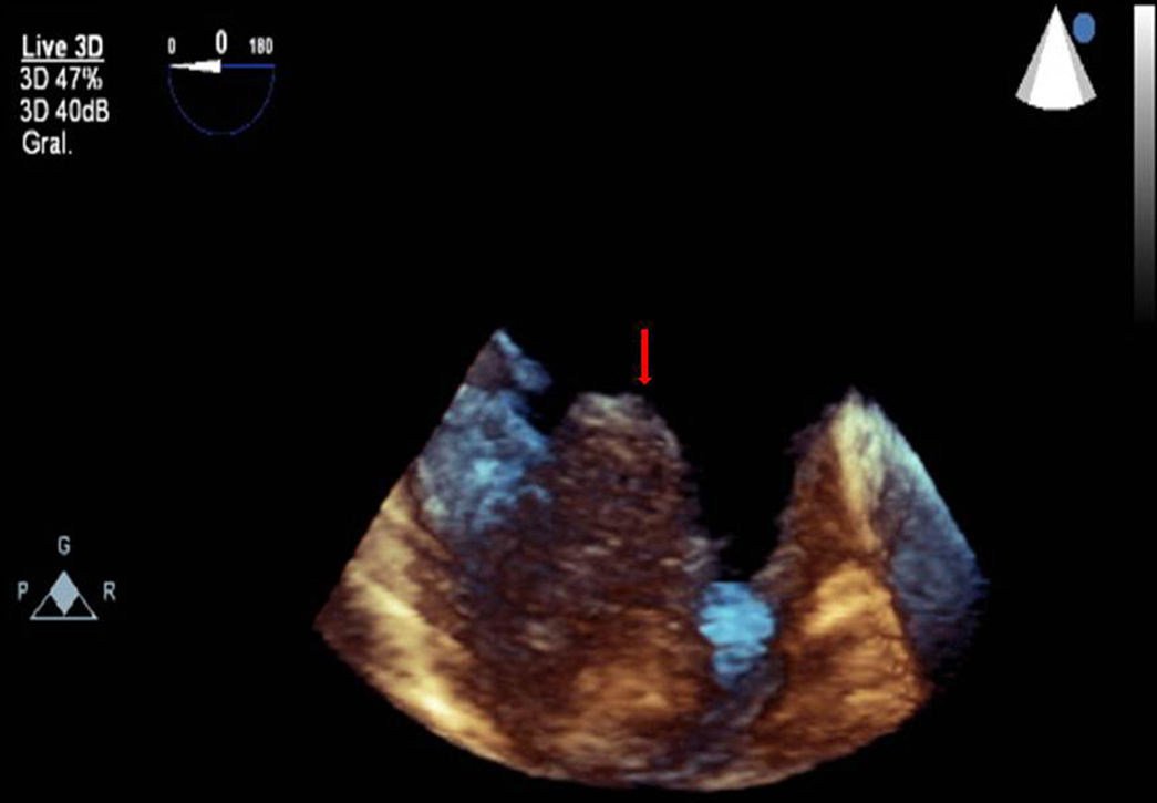 Pregnancy After Fontan-Kreutzer Surgery | Revista Española de Cardiología