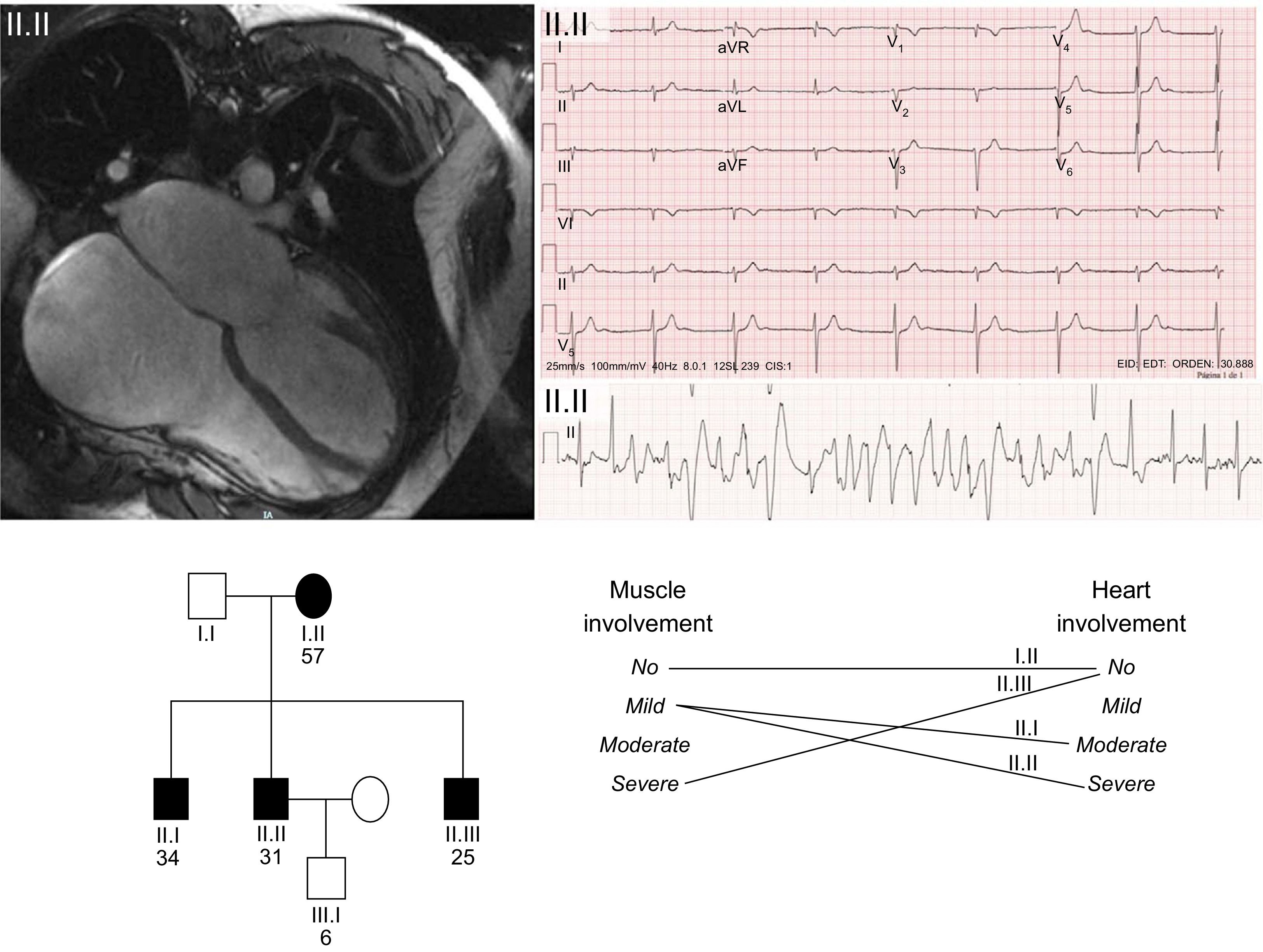 Cardiac Manifestations of Neuromuscular Disease | Revista Española de ...