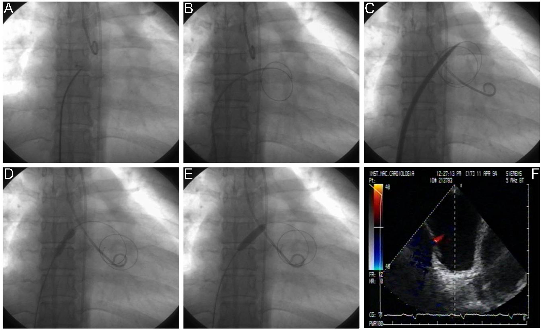 Interventional Therapies in Pulmonary Hypertension - Revista Española ...