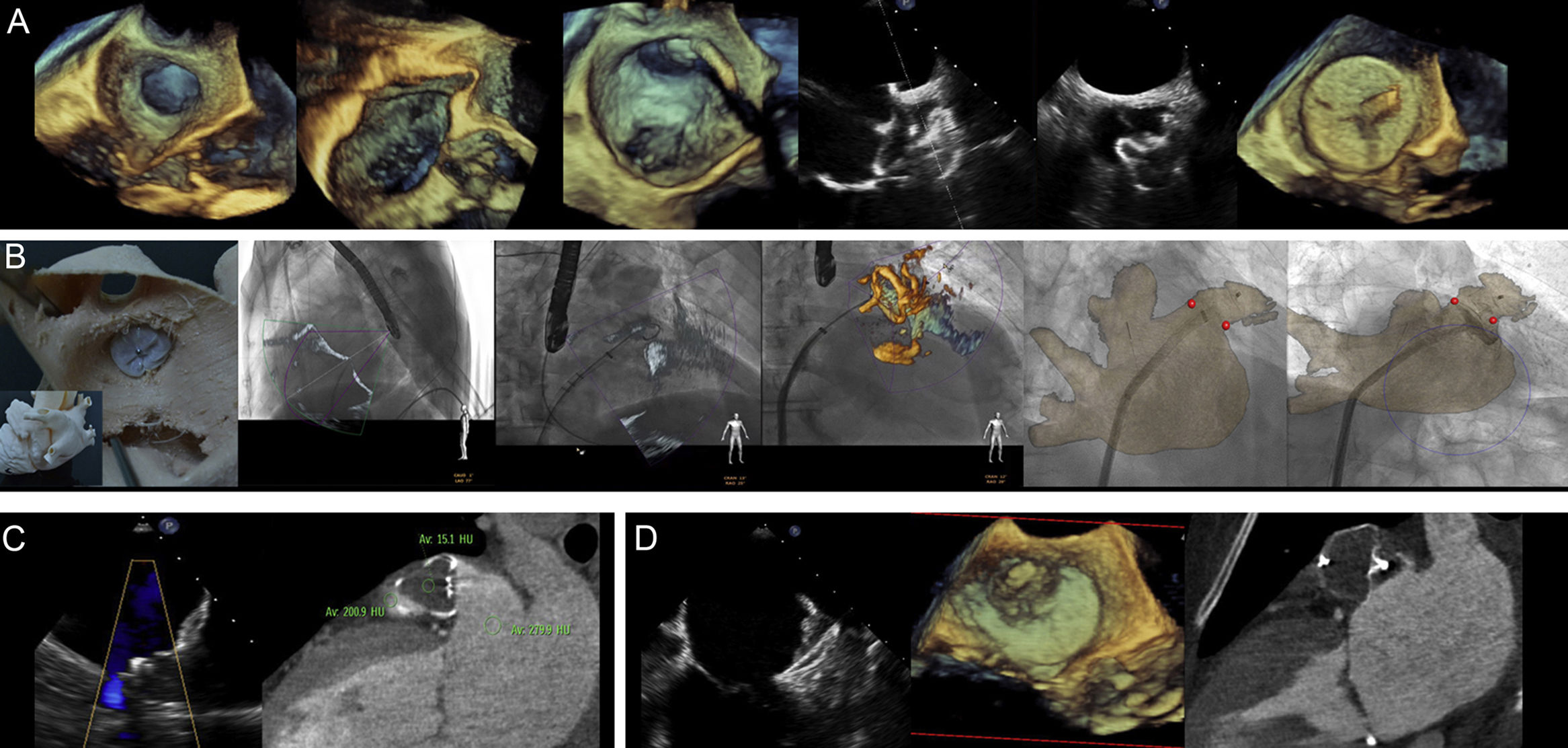 Percutaneous Left Atrial Appendage Occlusion: Multimodality Imaging ...