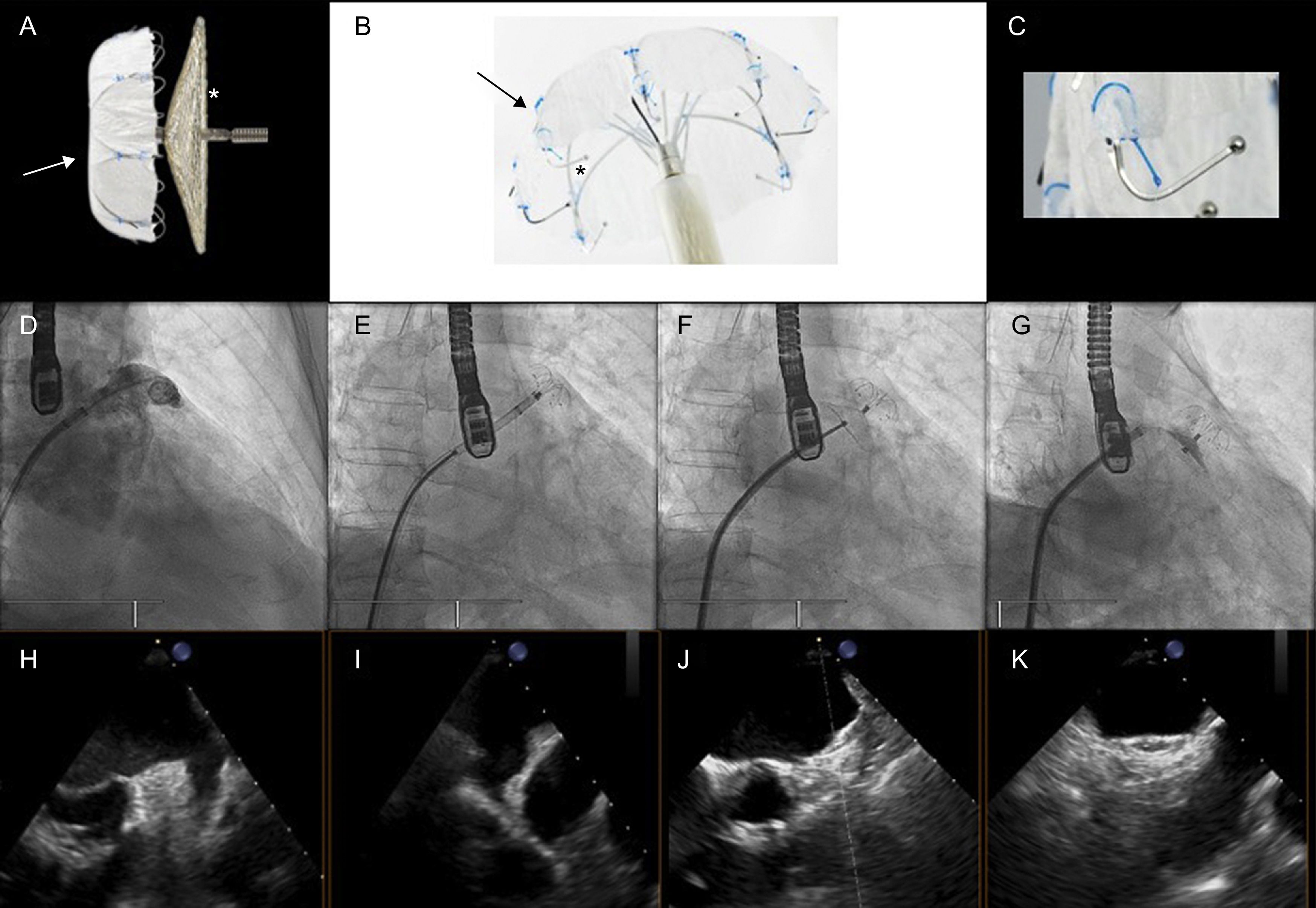 Left Atrial Appendage Occlusion With the LAmbre Device: Initial ...