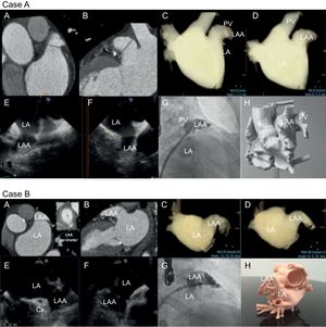 Patient-specific 3D-printed Cardiac Model for Percutaneous Left Atrial ...