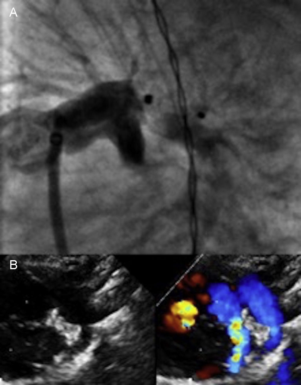 Transcatheter Occlusion of Patent Ductus Arteriosus in Preterm Infants ...