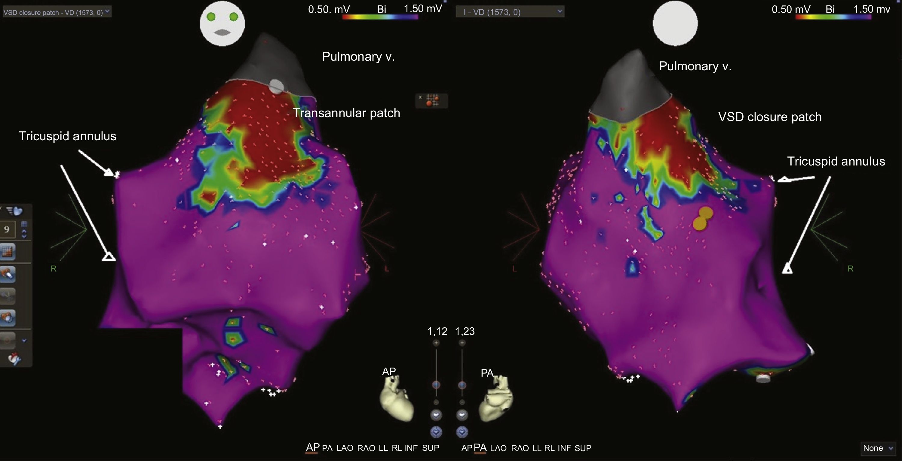 Sustained Ventricular Tachycardia After Thoracic Traumatism in a ...