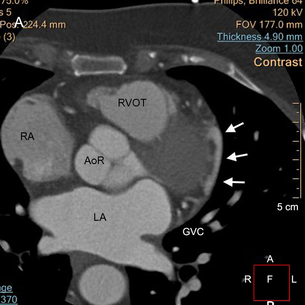 Congenital Fistula of the Left Atrial Appendage | Revista Española de ...