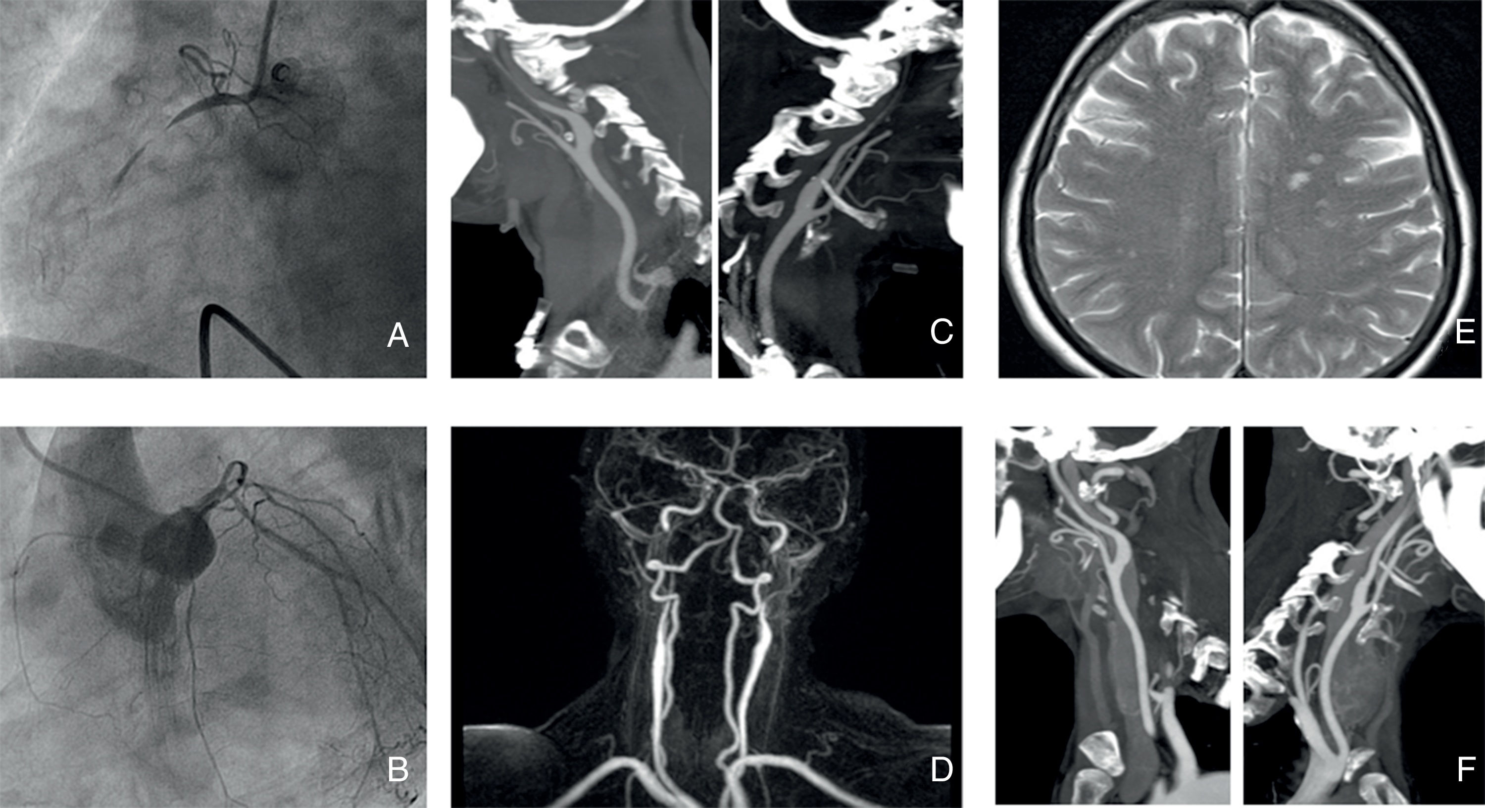 Acute Myocardial Infarction, Stroke and Bilateral Carotid Vasospasm: A ...
