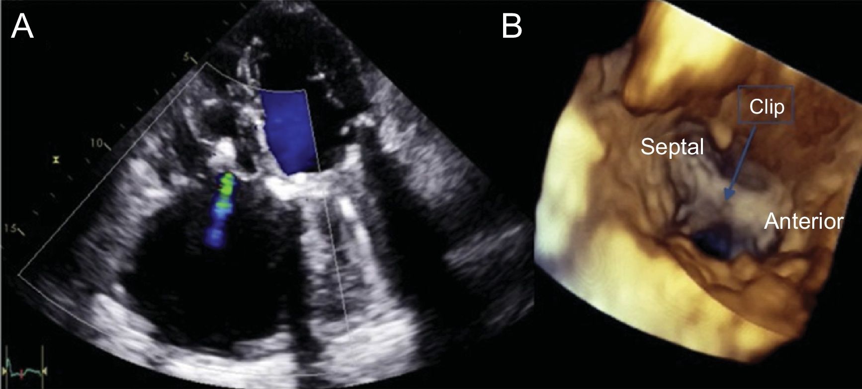 Transcatheter Tricuspid Repair With MitraClip in a Patient With a ...