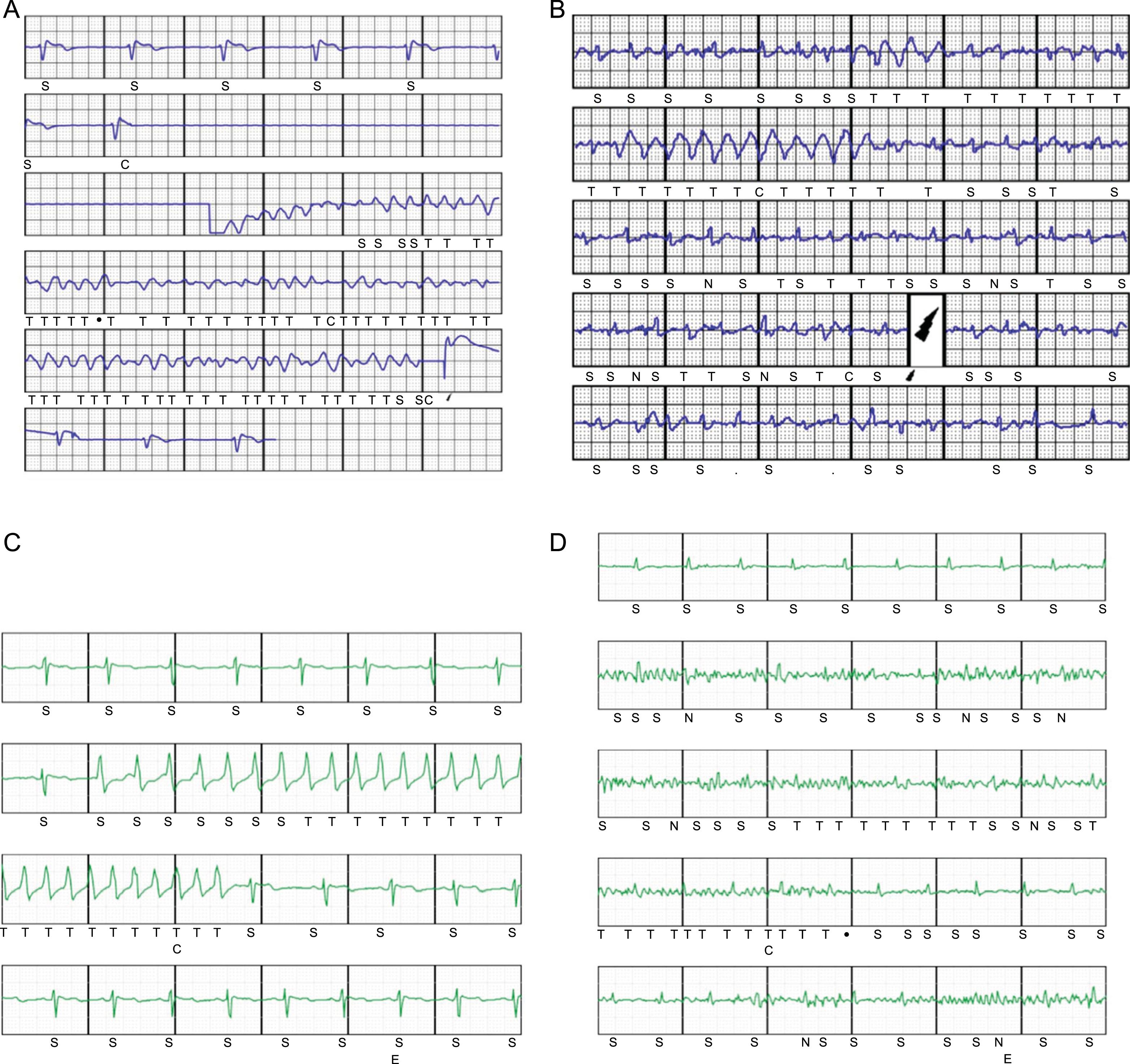 Acute and Long-term Results After Contemporary Subcutaneous Implantable ...