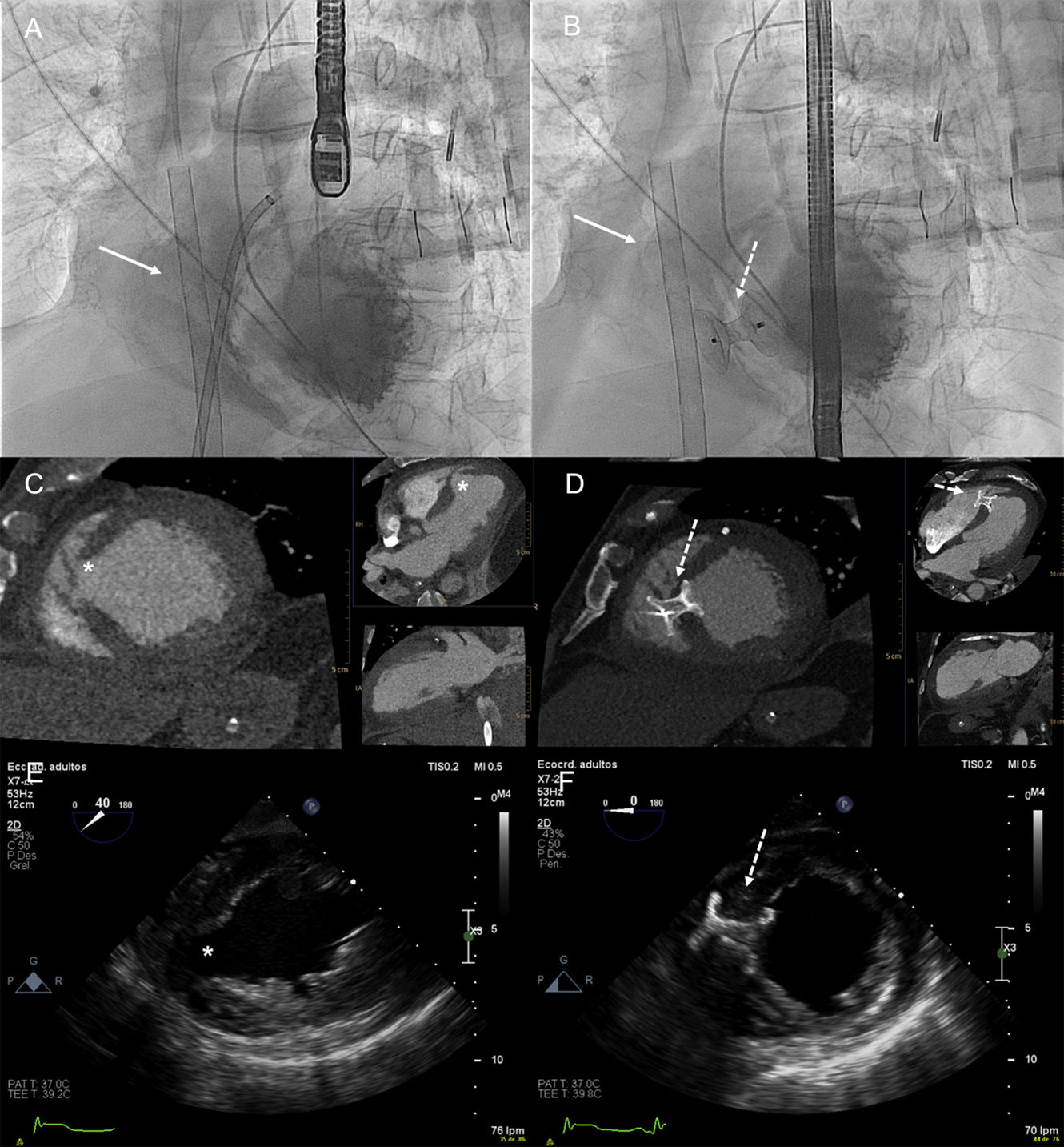 Device Closure of a Ventricular Septal Rupture in a Patient on ECMO ...