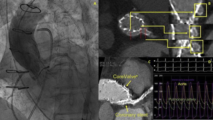 Chimney Stent Technique in a Valve-in-valve Procedure | Revista ...