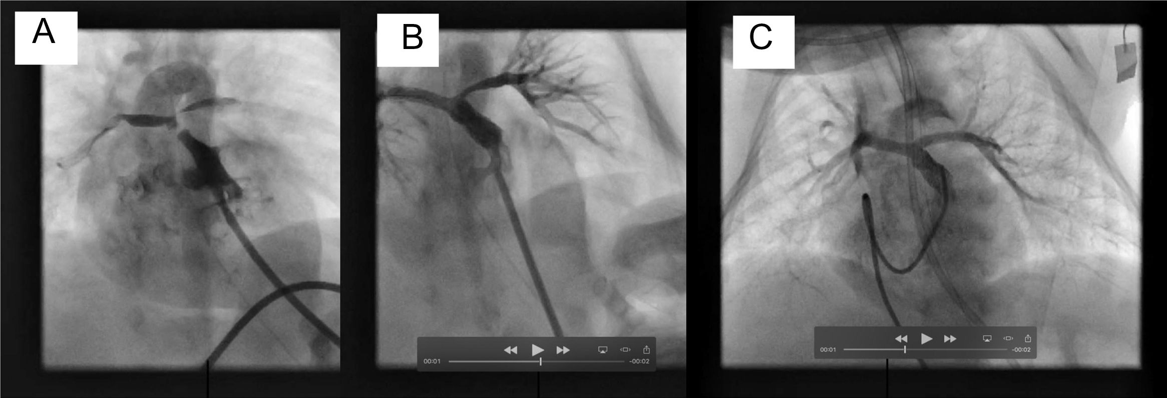 Pulmonary Valve Perforation and Stent Implantation in the Right ...