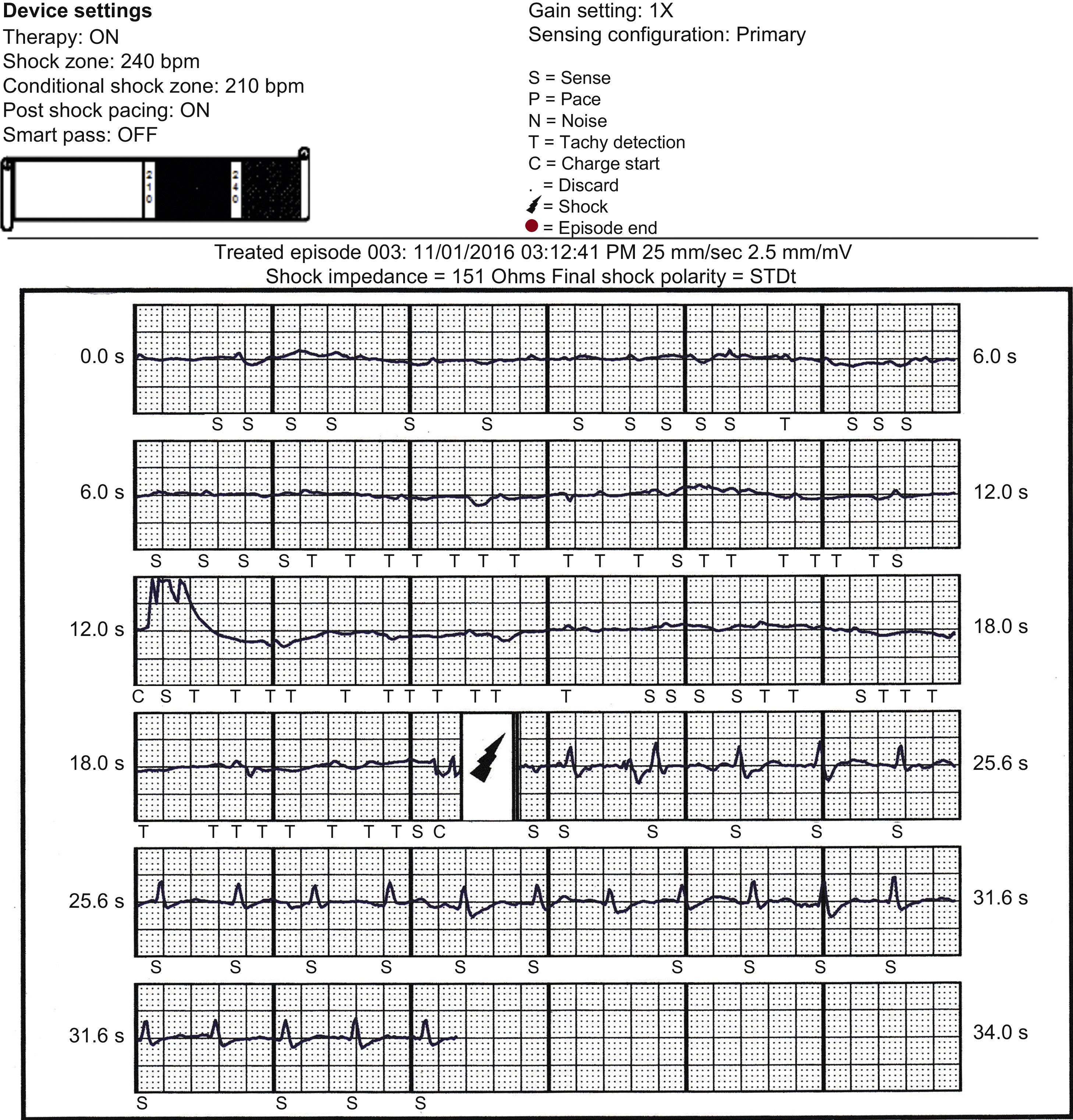 Inappropriate Shock Due to Air Entrapment in the Pocket of a ...