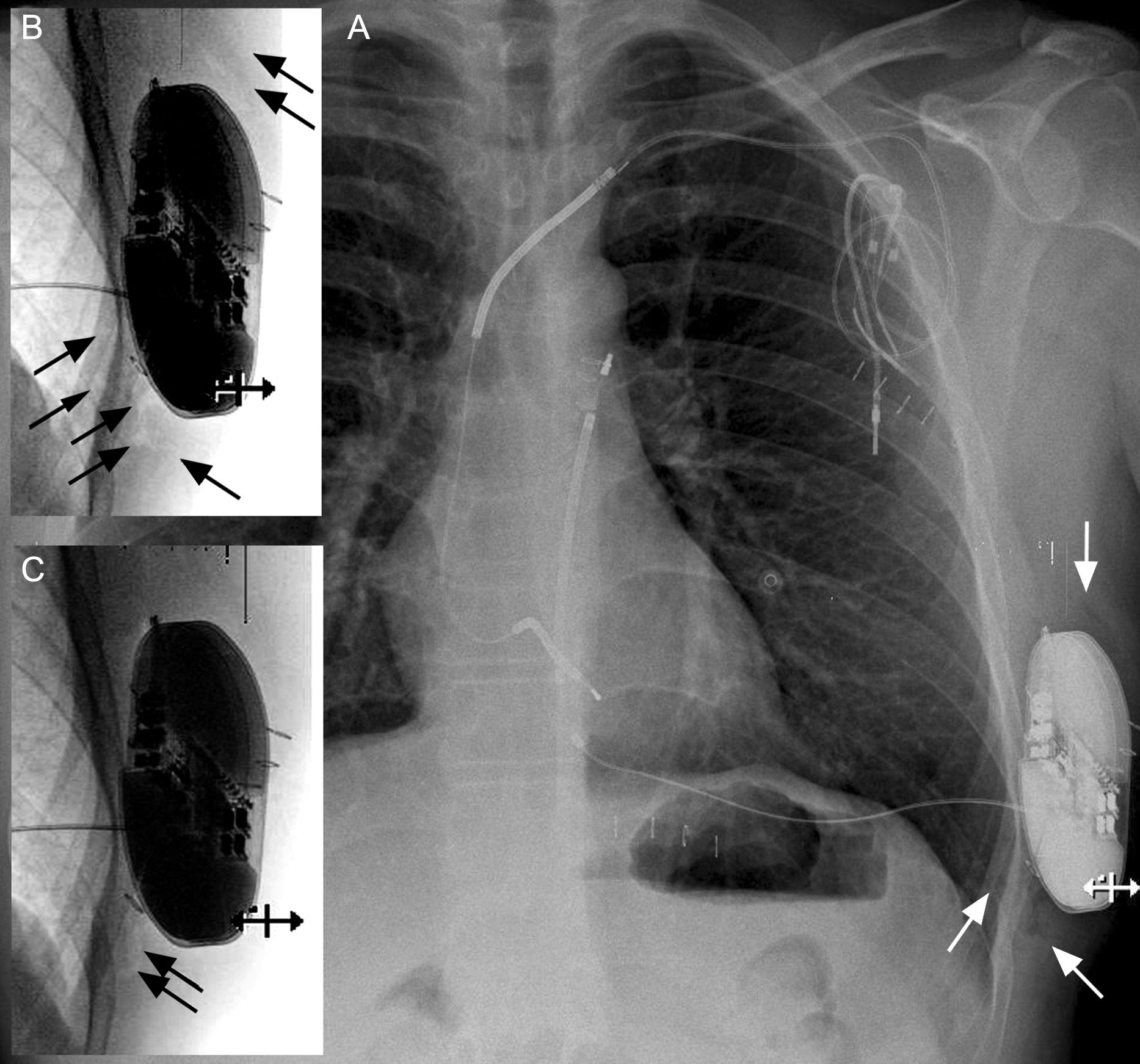 Inappropriate Shock Due to Air Entrapment in the Pocket of a ...