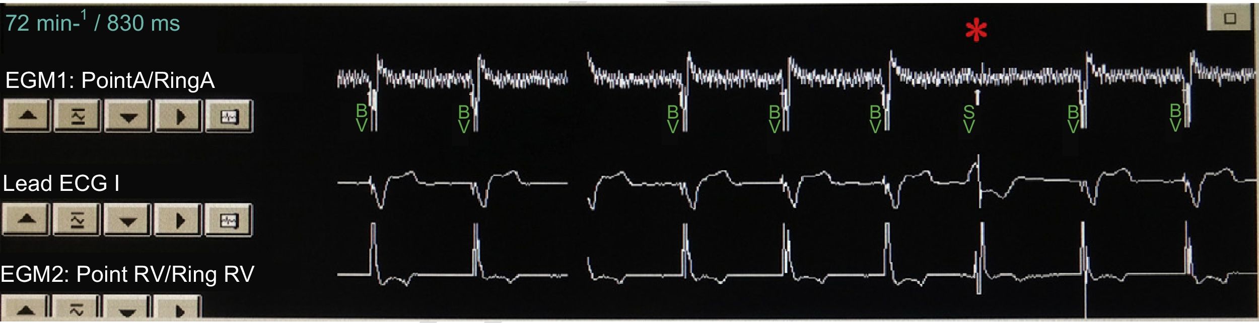 Response to ECG, December 2018 | Revista Española de Cardiología