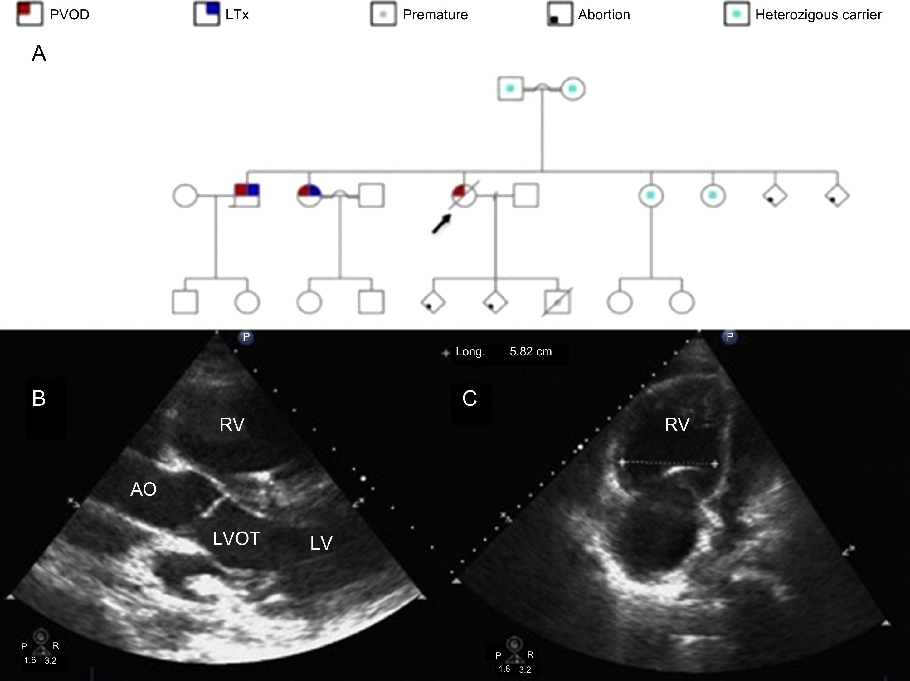 Extracorporeal Membrane Oxygenation Support During Pregnancy in ...