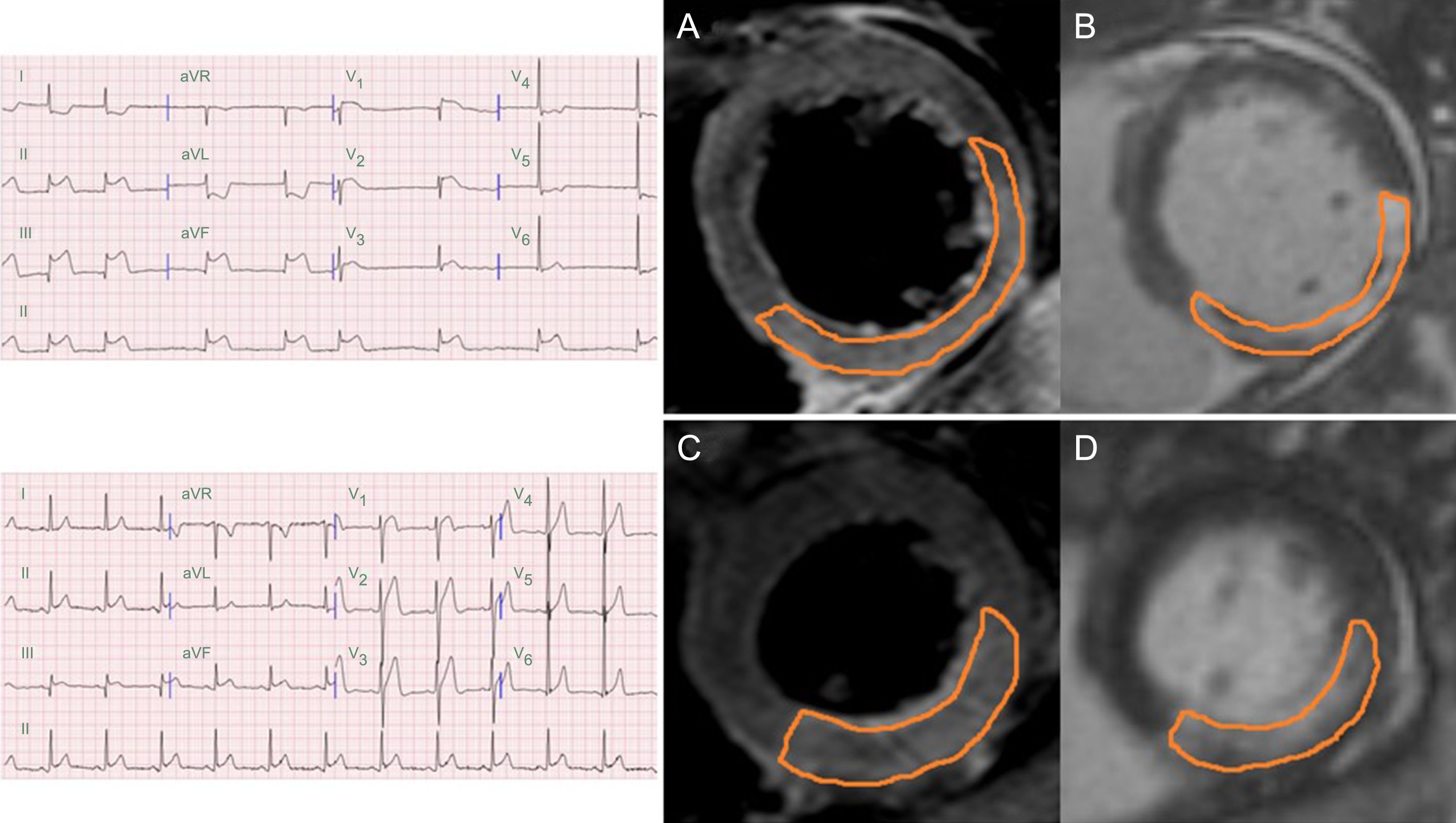 Clinical Significance of Reciprocal ST-segment Changes in Patients With ...