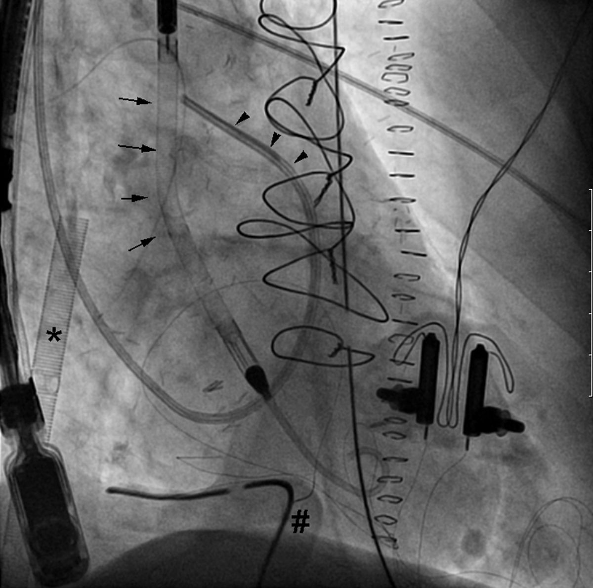 Combined Venoarterial Extracorporeal Membrane Oxygenation and Impella ...