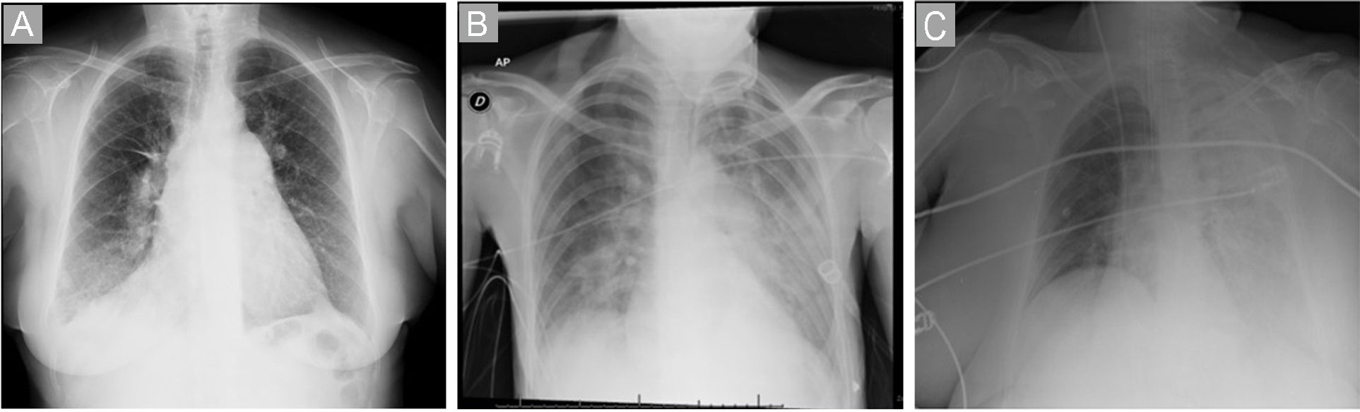 Balloon Pulmonary Angioplasty for Inoperable Patients With Chronic ...