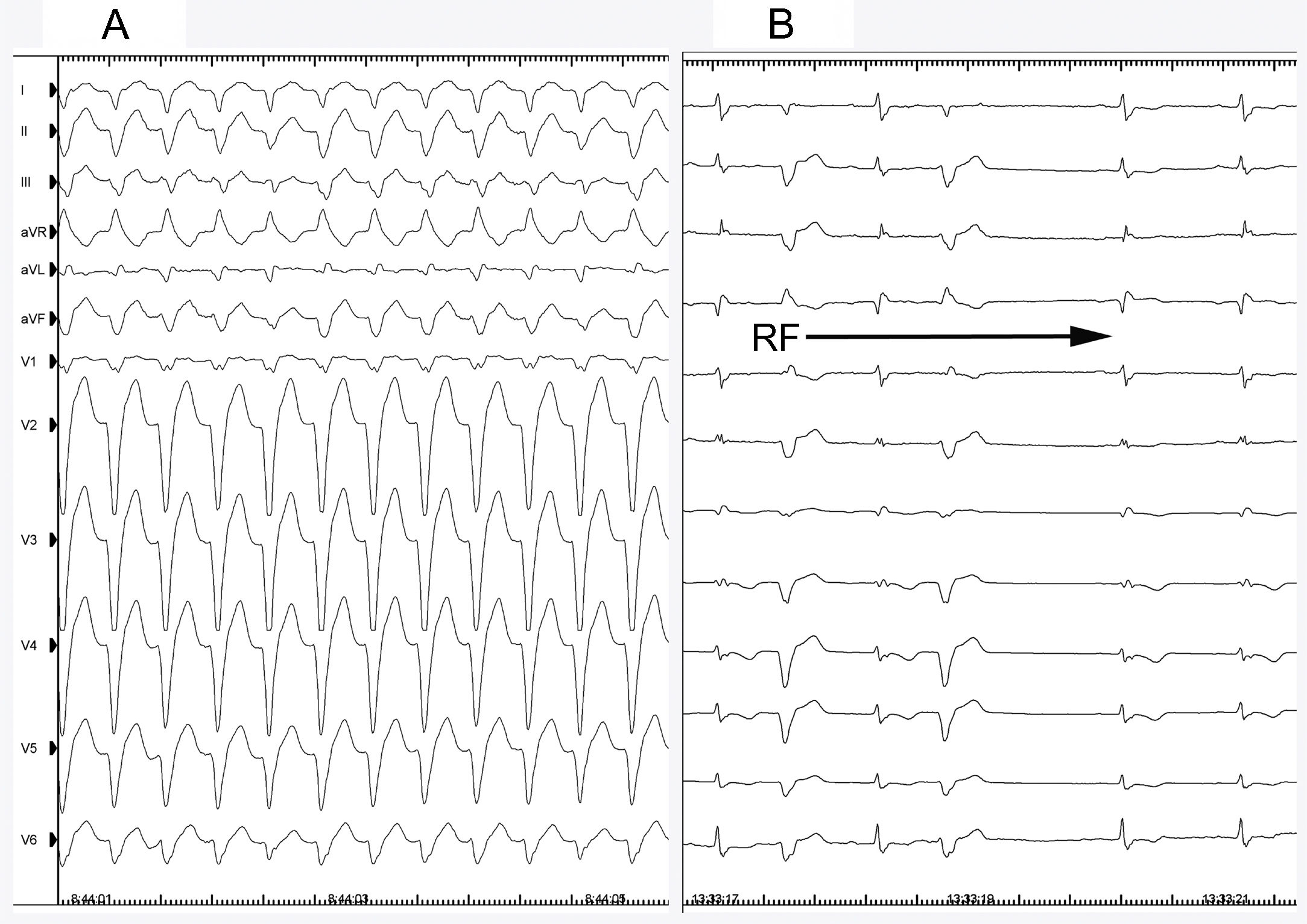 Leadless Pacemaker Implantation in a Transplanted Heart | Revista ...