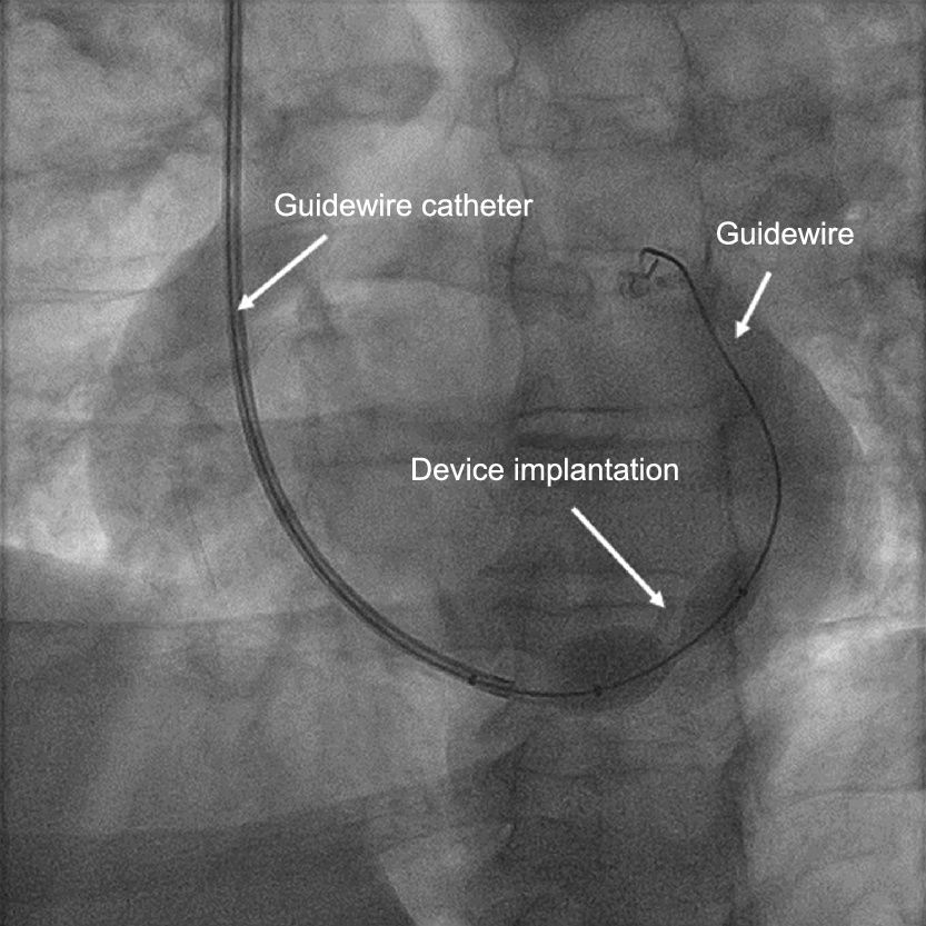Device to Narrow the Coronary Sinus in Refractory Angina | Revista ...